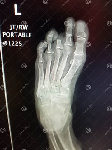 Left Third Toe Proximal Phalanx Amputation - Plain X-ray Stock Photo ...