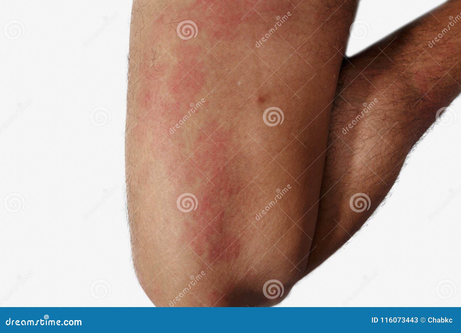 Rash Allergy From Touching Arms ,eczema, Dermatitis Royalty-Free Stock ...