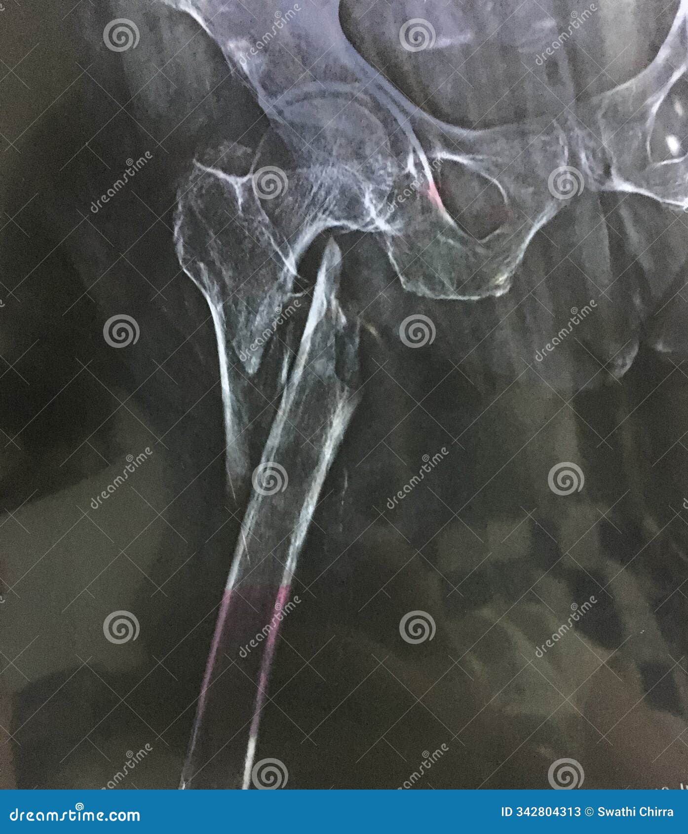 Bone Fracture Royalty-Free Stock Image | CartoonDealer.com #54625996
