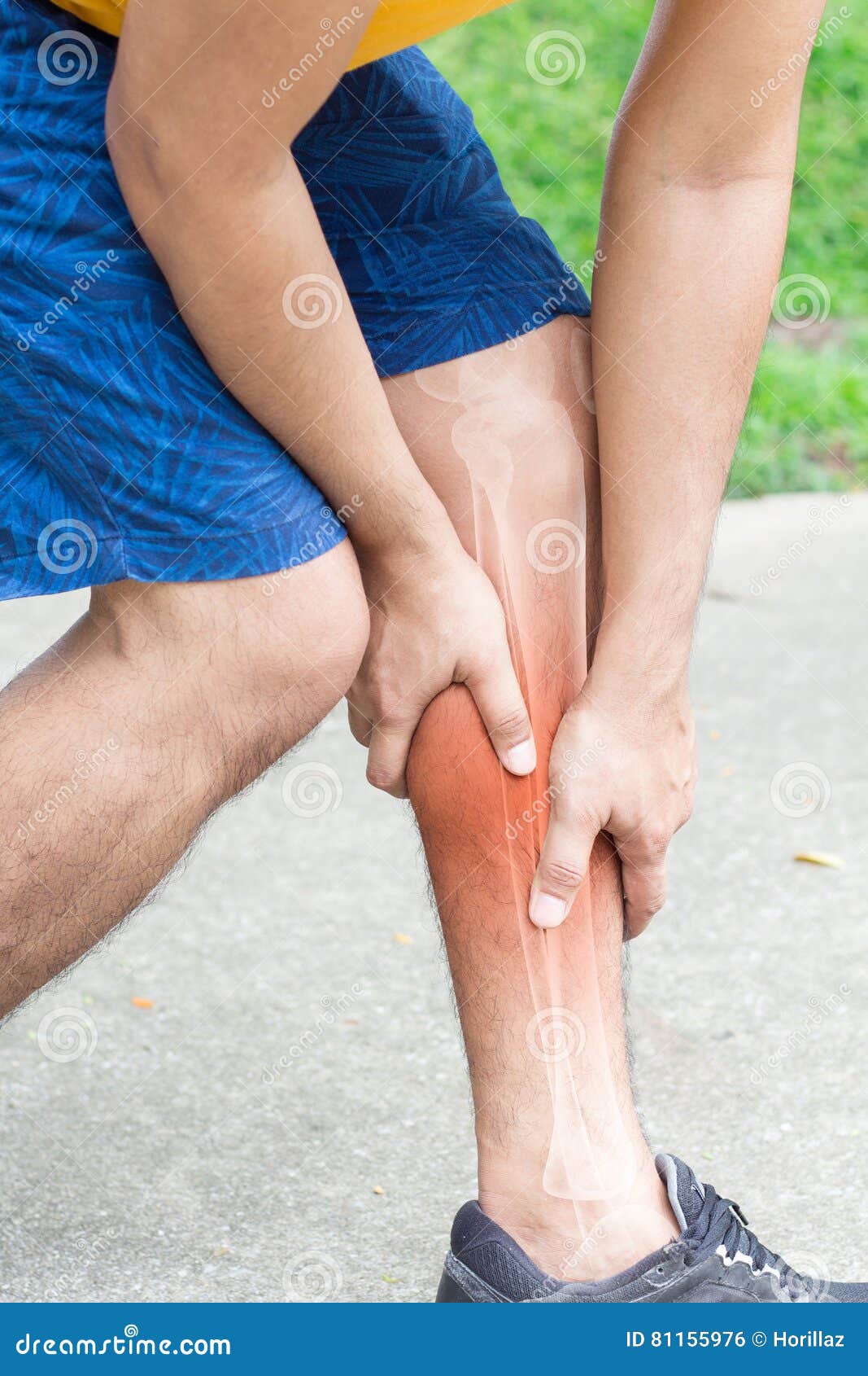 Leg bones injury stock photo. Image of arthritis, injury - 81155976