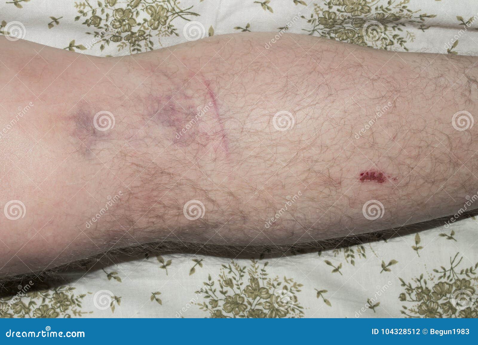 Leg after broken knee stock photo. Image of closeup - 104328512