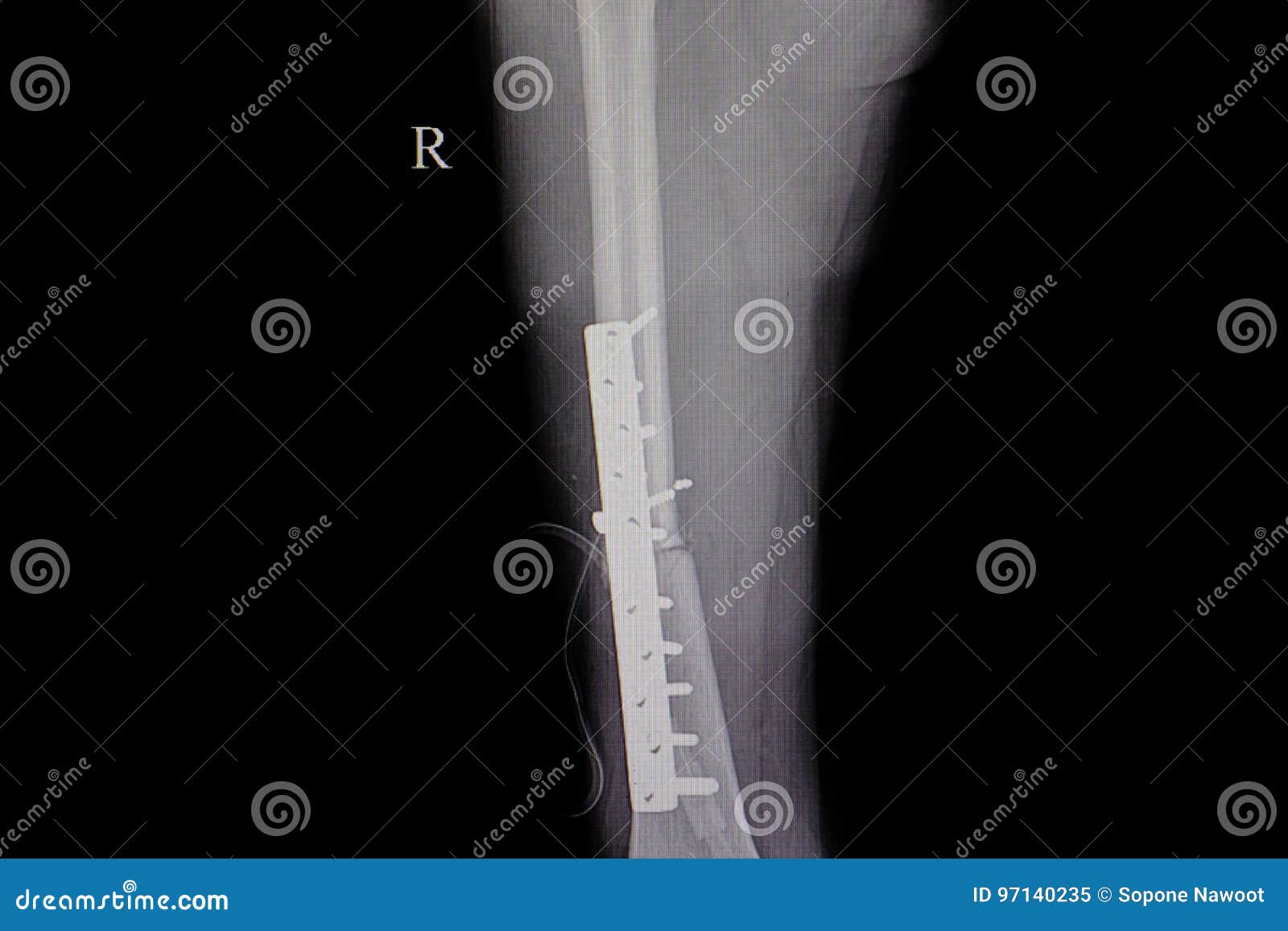Leg film stock image. Image of doctor, treatment, medicine - 97140235