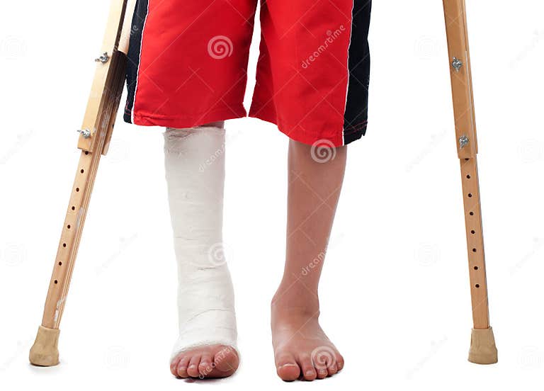 Leg fracture stock image. Image of human, injury, broken - 27563029