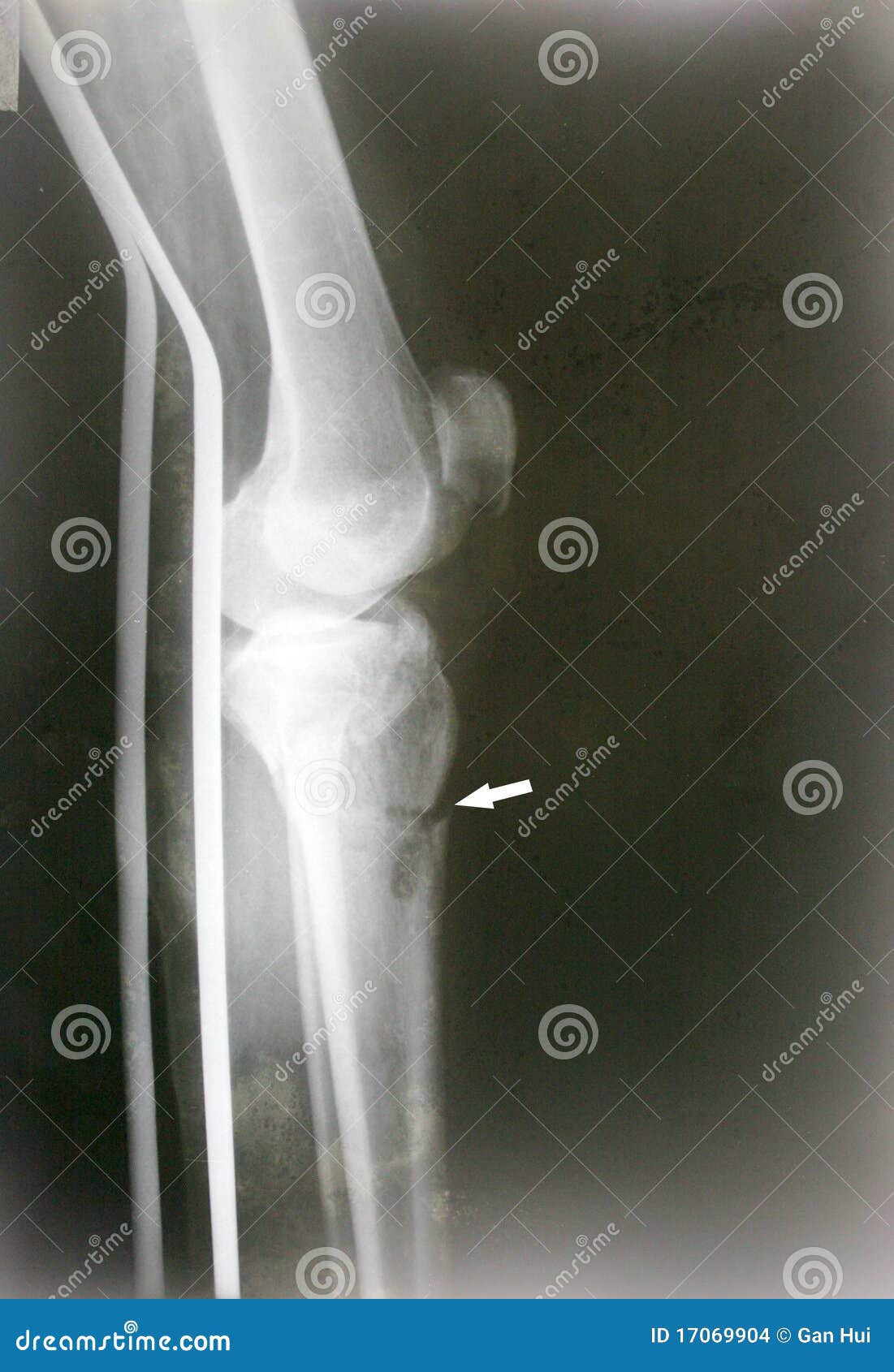 Leg fracture x-ray stock photo. Image of break, clinic - 17069904