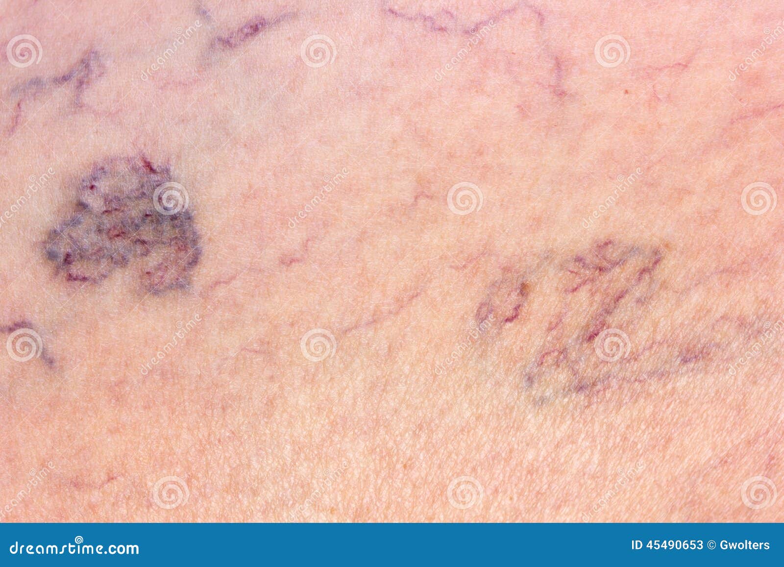 Leg full of varicose veins stock image. Image of anatomy - 45490653