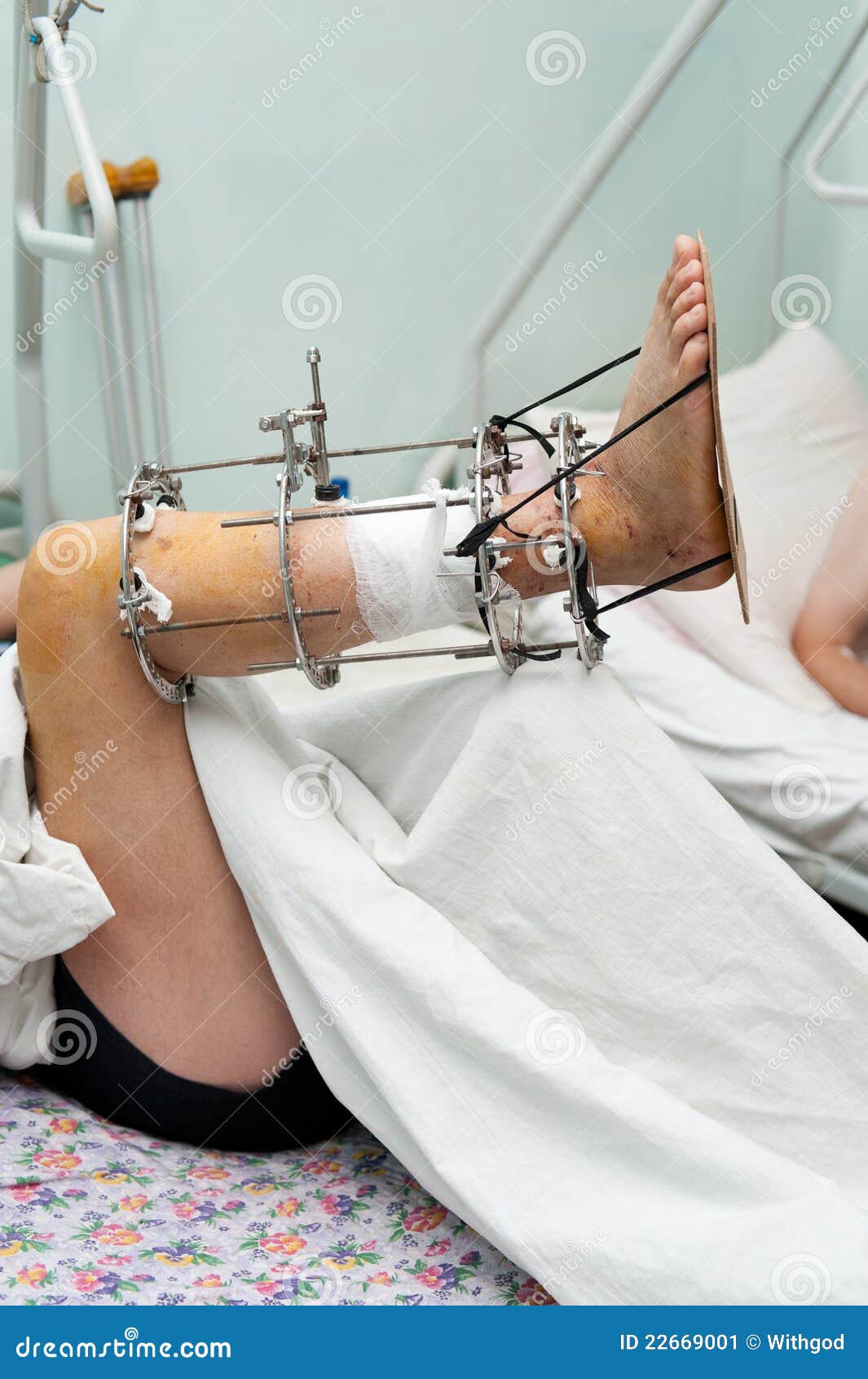 Leg in Ilizarov S External Fixator Stock Image - Image of shank ...