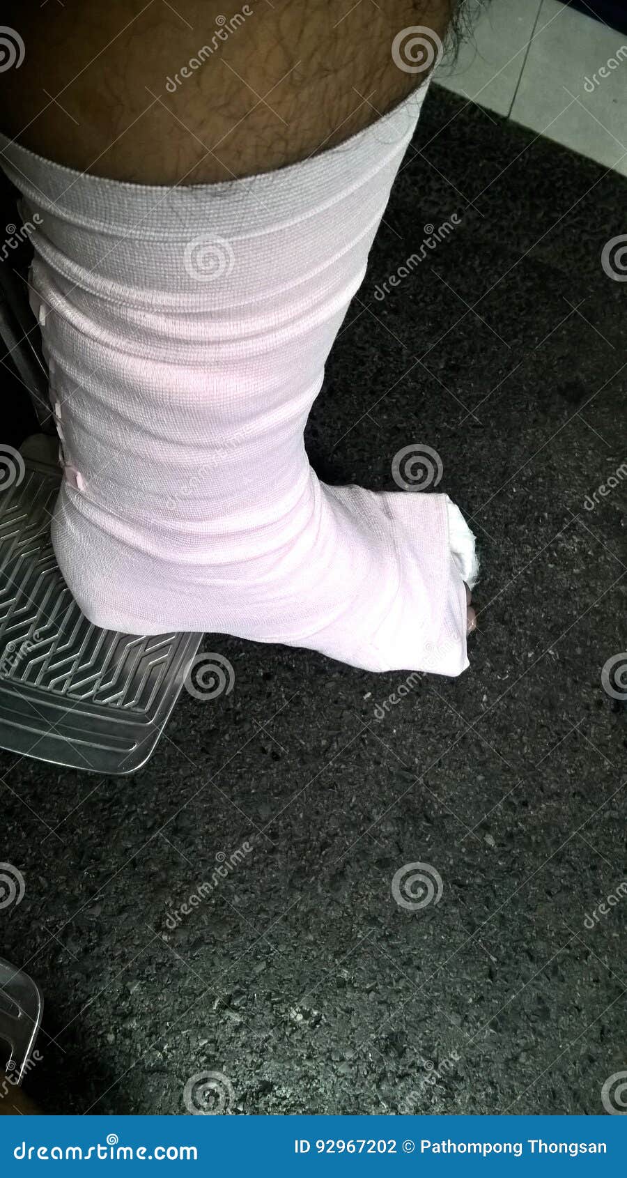 Leg injury. stock photo. Image of ankle, foot, physical - 92967202