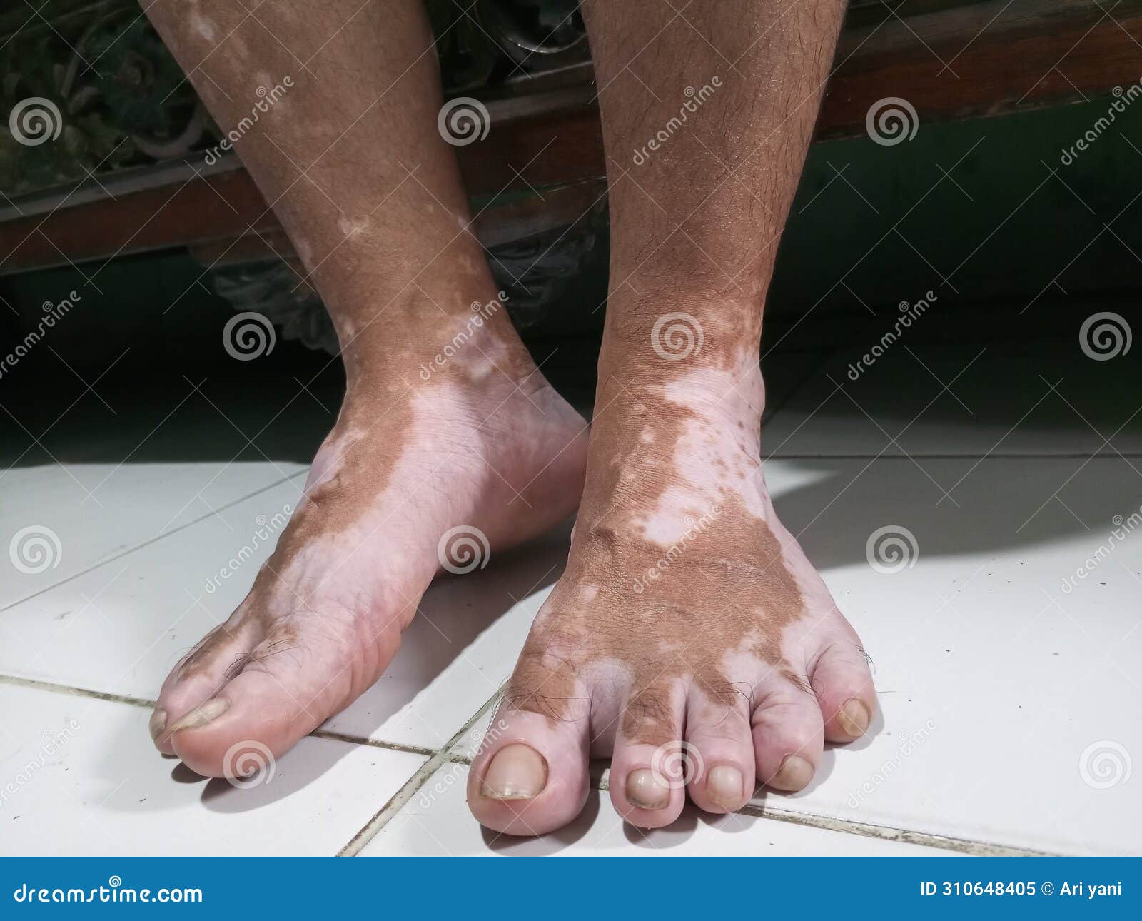 The Leg of a Man Affected by Vitiligo Stock Image - Image of treatment ...