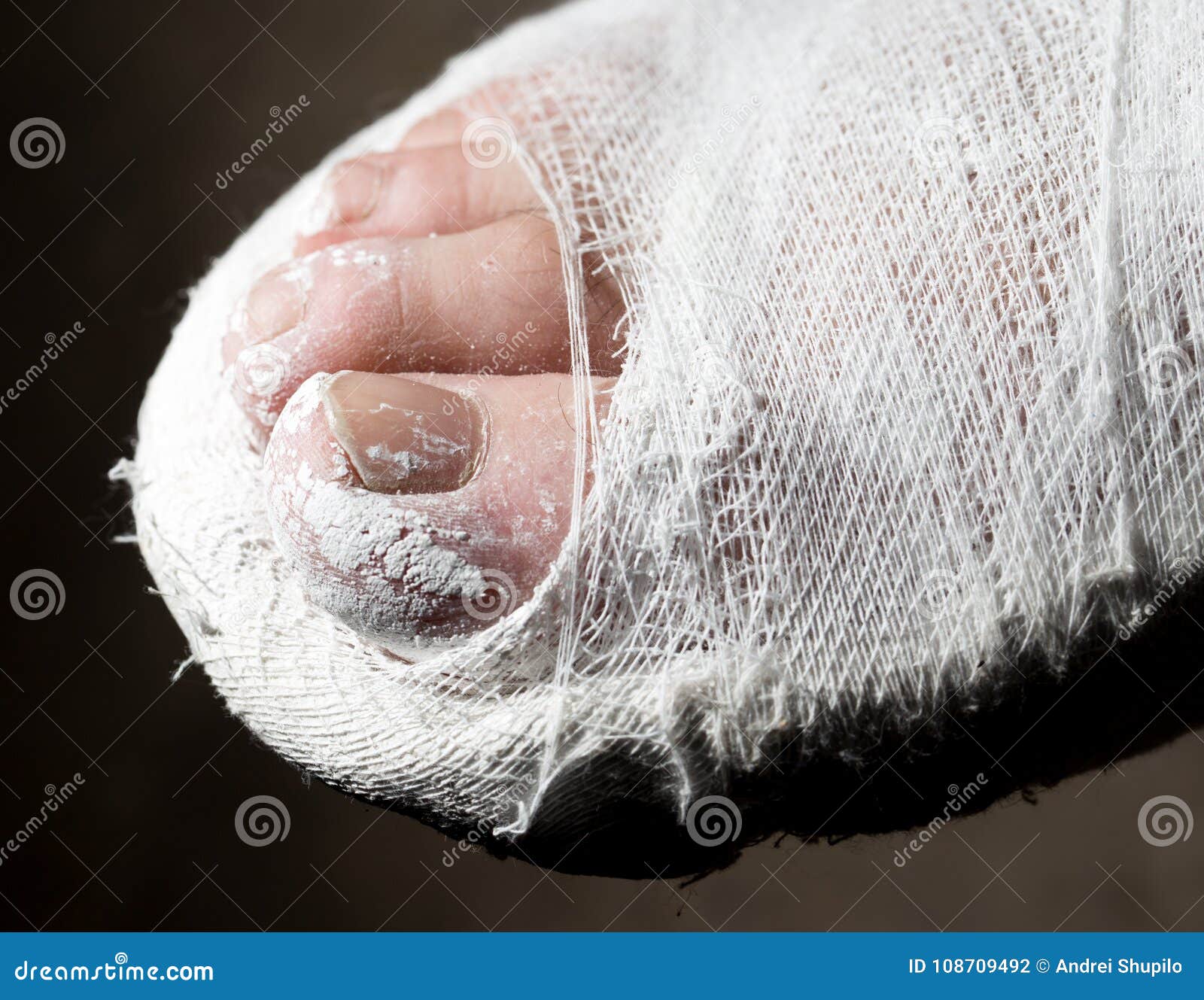 Leg in a Plaster Cast on a Black Background Stock Photo - Image of foot ...