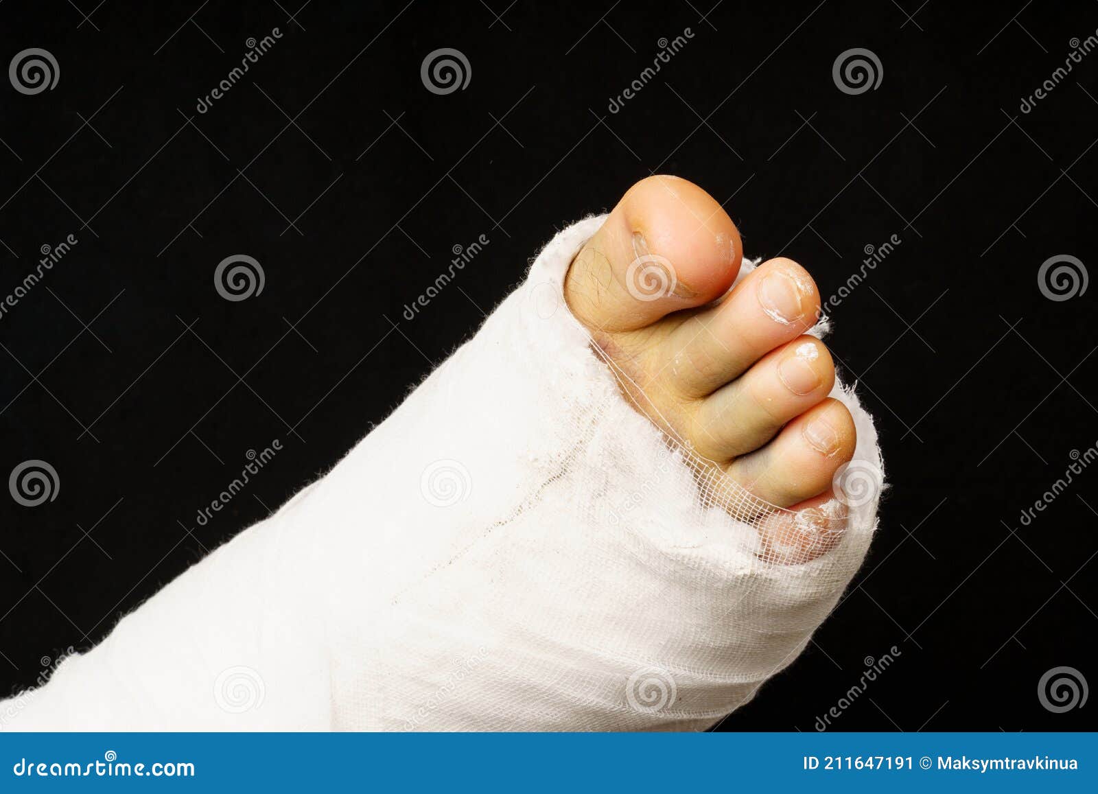 A Leg in a Plaster Cast with a Black Background Stock Image - Image of ...