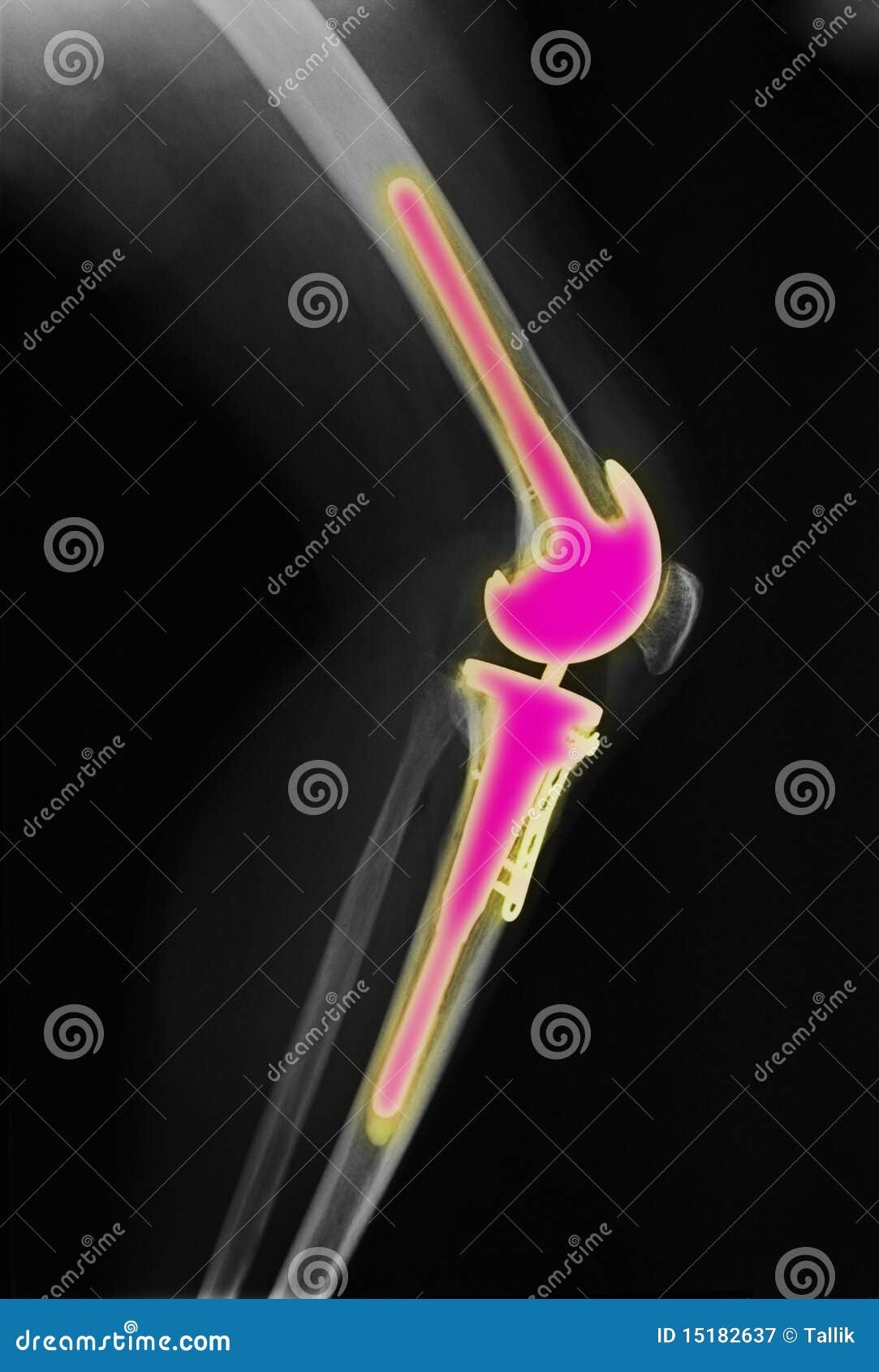Leg X-ray, 46 Year Old Female, Knee Replacement Stock Image - Image of ...