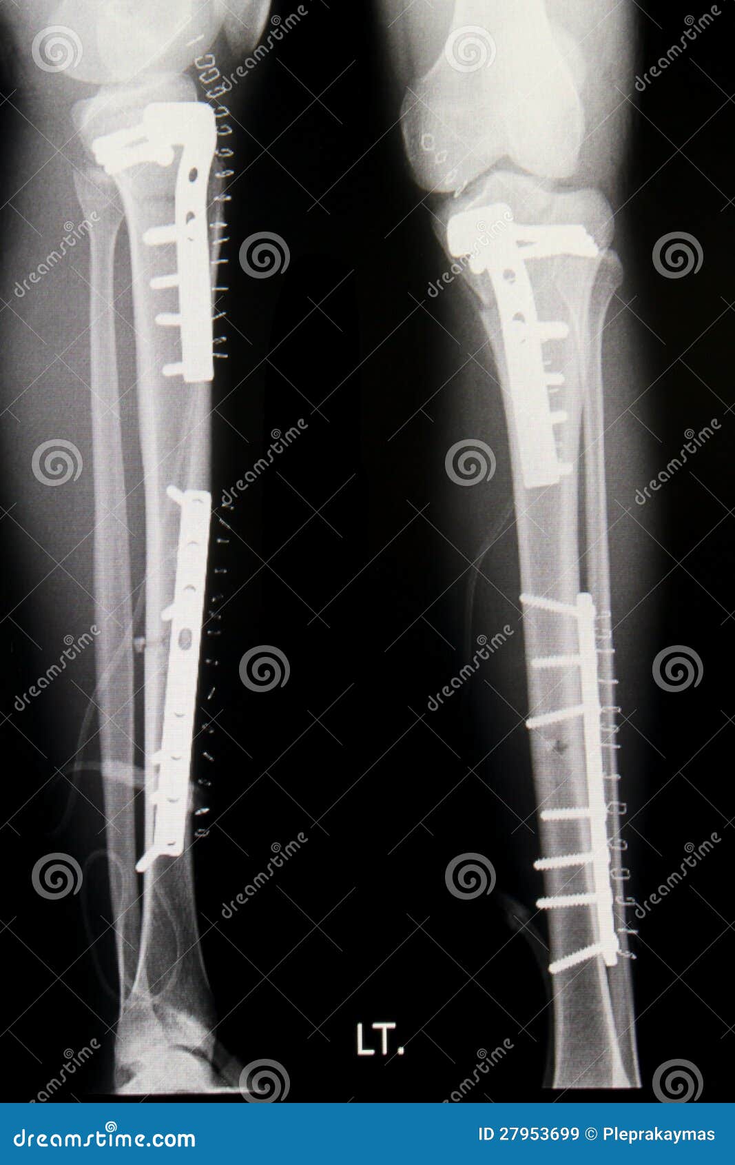 Leg x-rays image stock image. Image of bone, diagnostics - 27953699