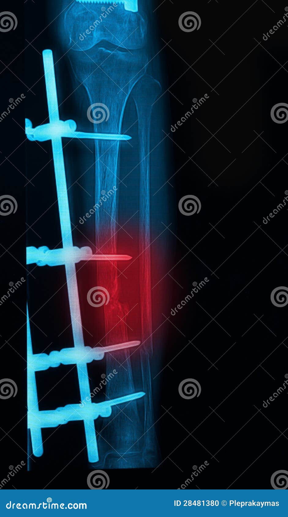 Leg X-rays Image Showing Plate and Stock Photo - Image of human ...