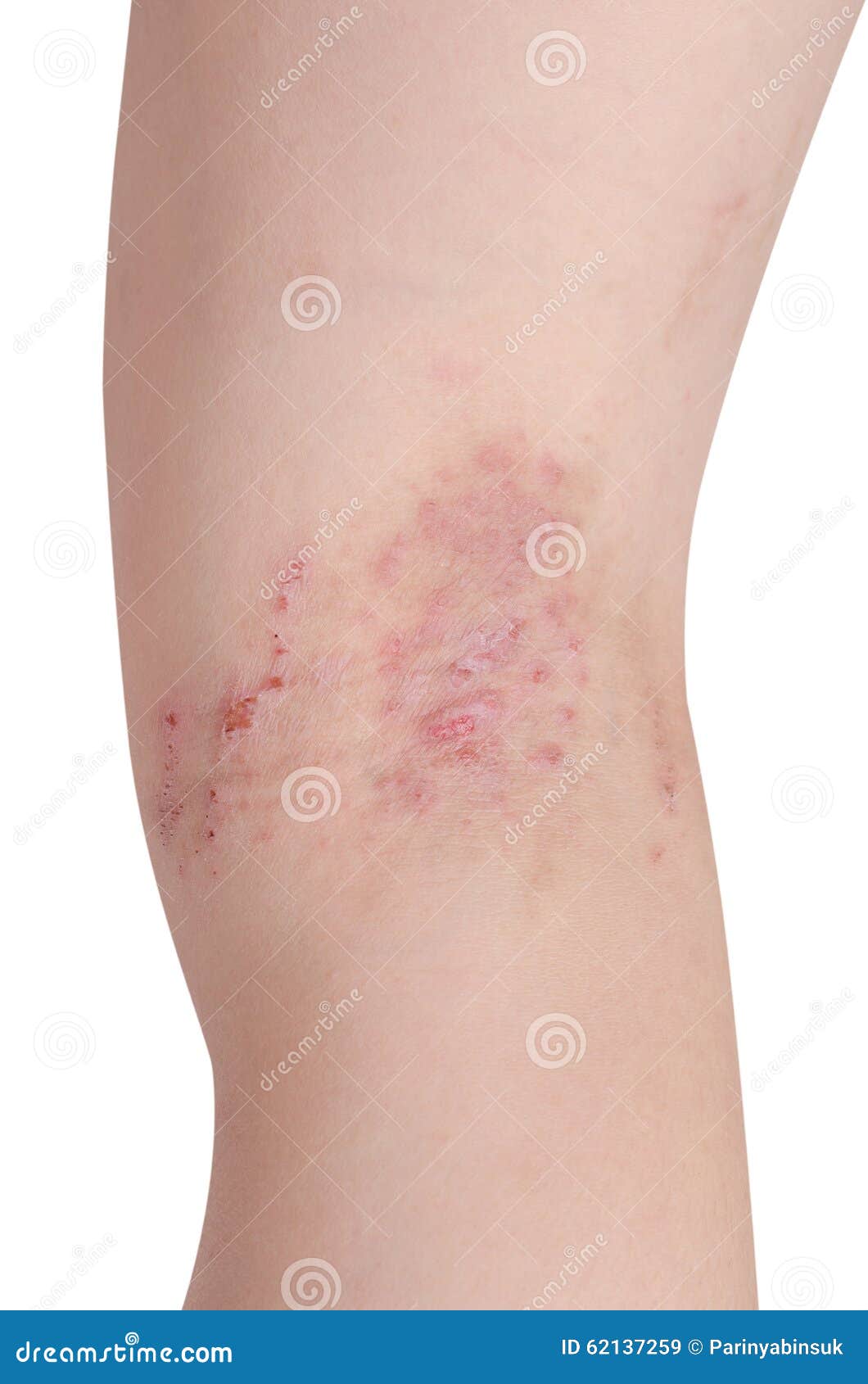 Leg with Sore from Scratching Stock Image - Image of body, background ...