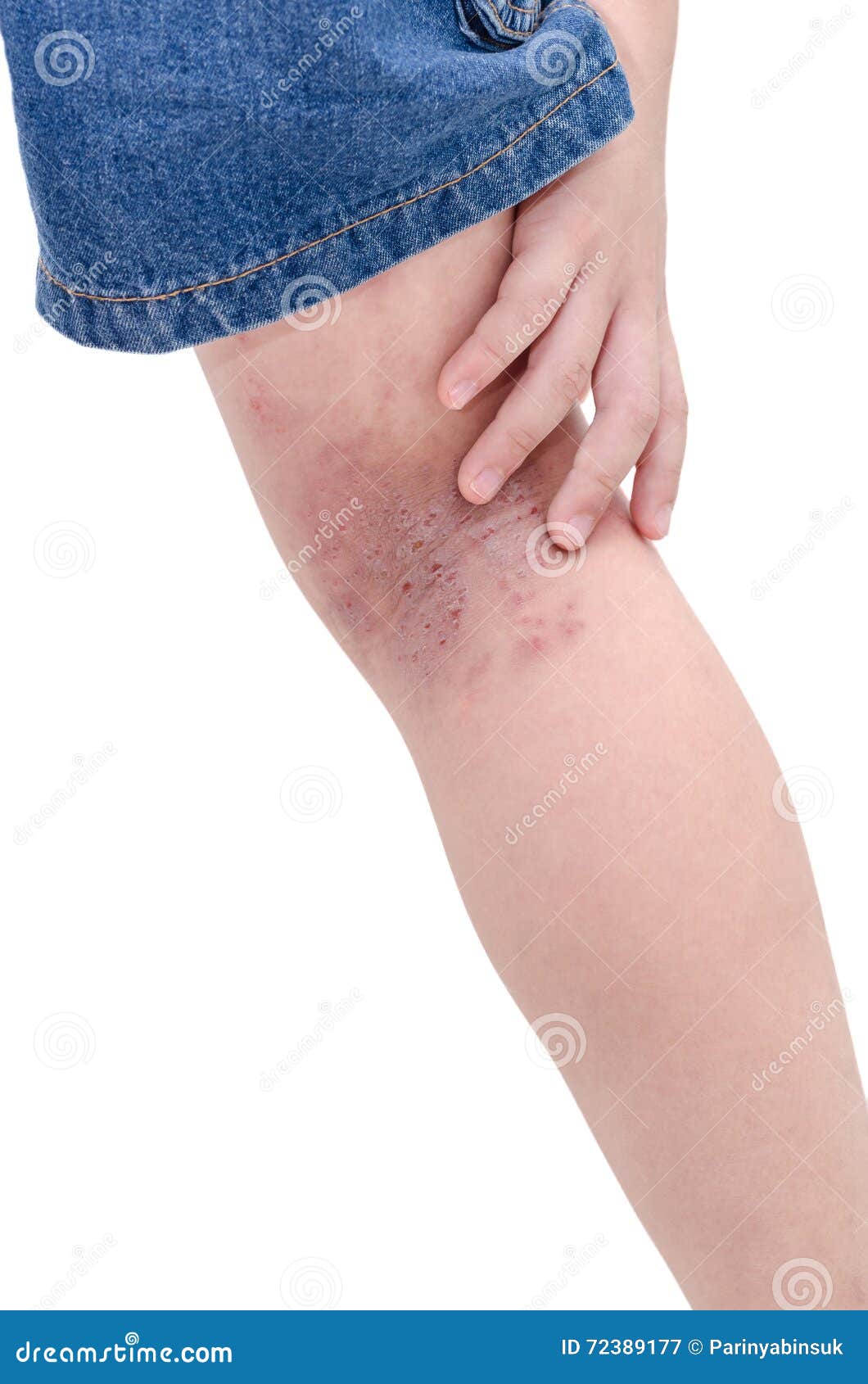 Leg with Sore from Scratching Stock Image - Image of bite, girl: 72389177