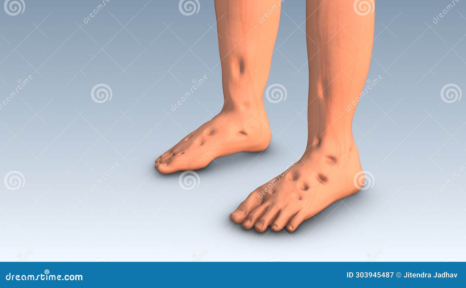 Leg Swelling or Lower Limb Edema Stock Illustration - Illustration of ...