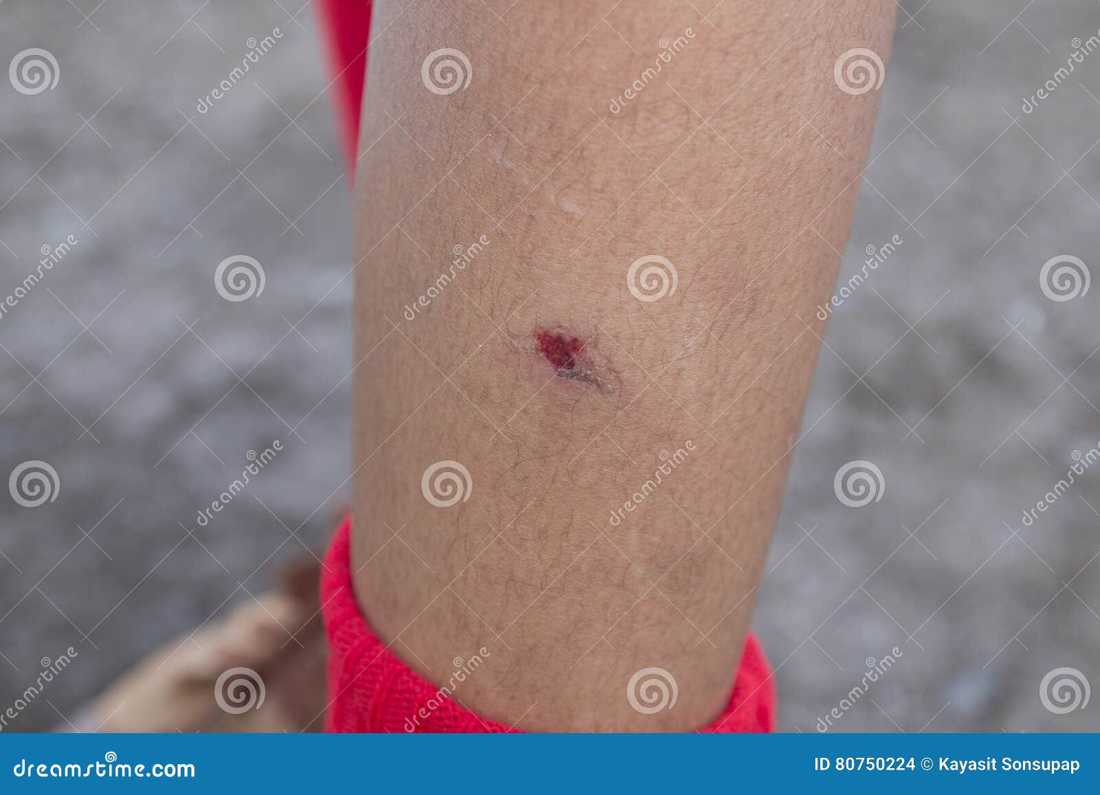 Leg ulcers stock photo. Image of closeup, hospital, medicine - 80750224