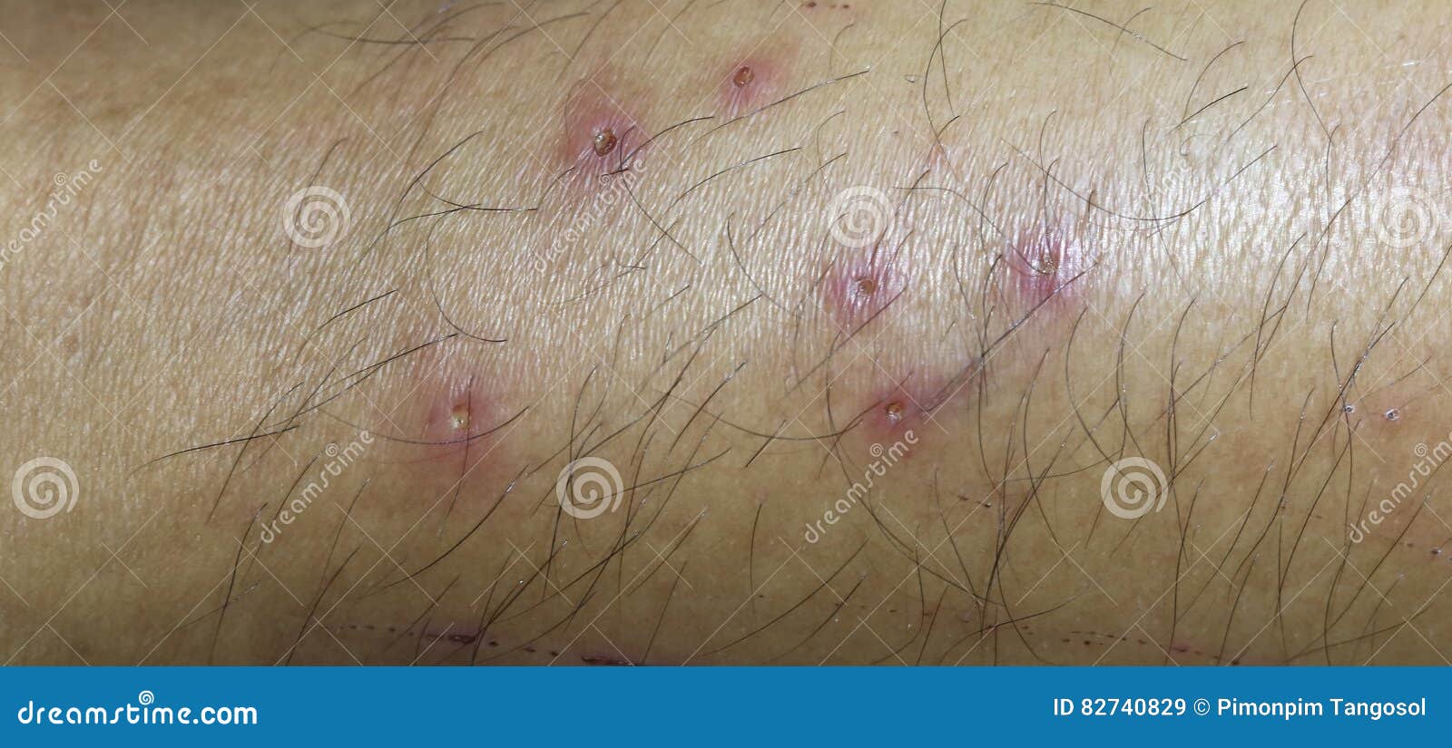 Infected Wound Of Leg Stock Image | CartoonDealer.com #75497431