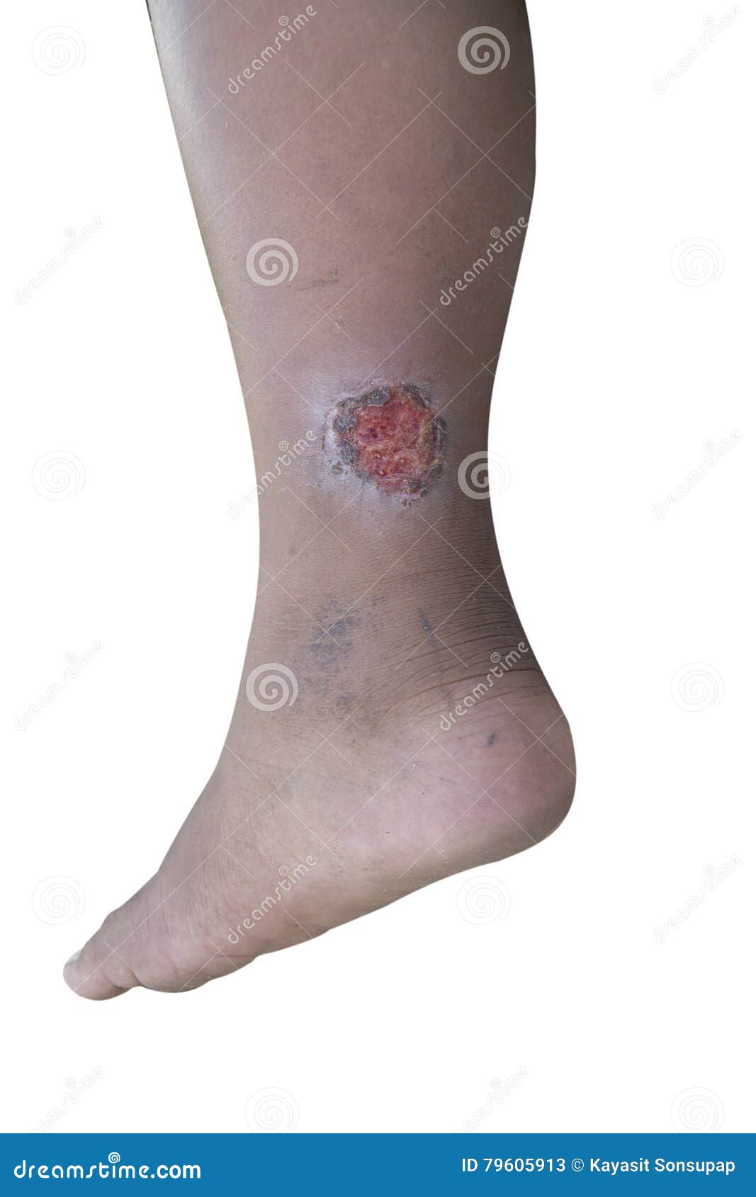 Leg ulcers stock image. Image of care, chronic, people - 79605913