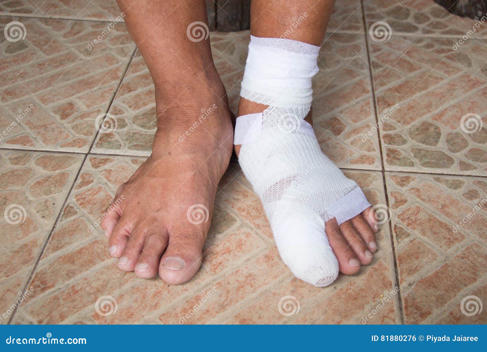 Leg was bandaged stock photo. Image of hurt, doctor, bandaged - 81880276
