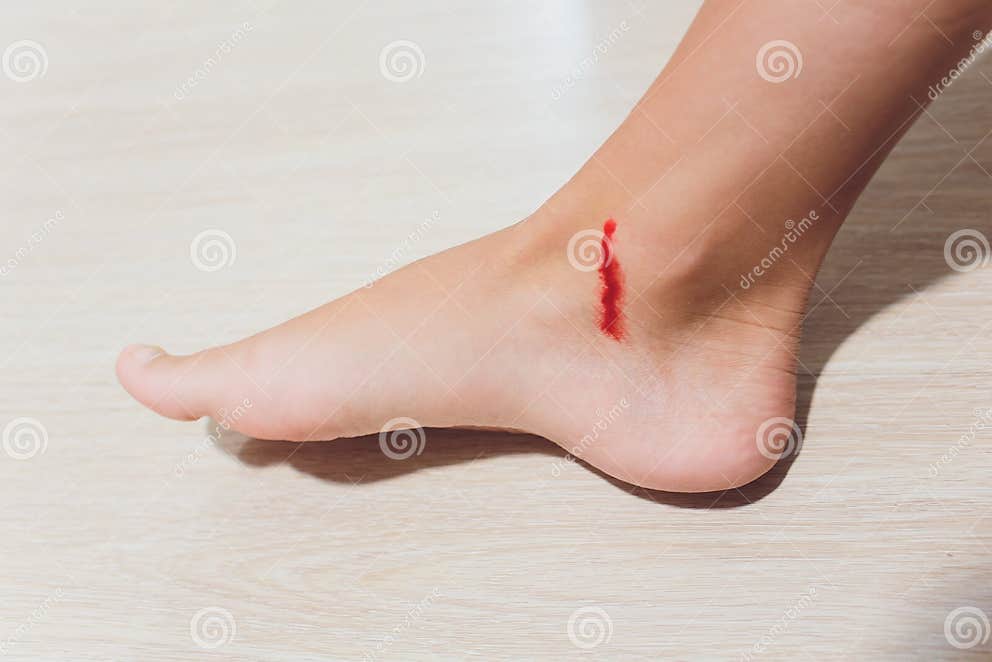 The Leg is Wound with Bleeding Caused by Scratching. Stock Image ...
