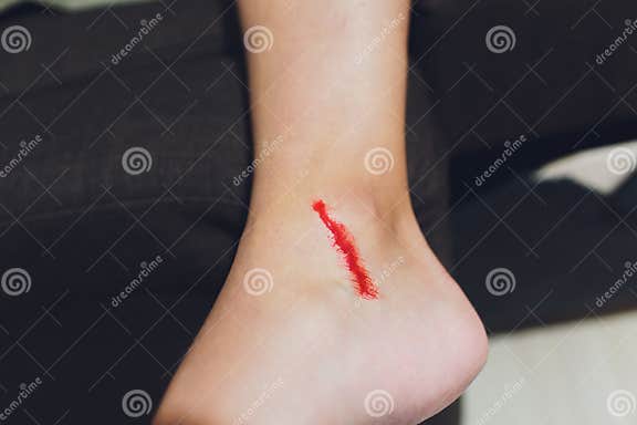 The Leg is Wound with Bleeding Caused by Scratching. Stock Photo ...