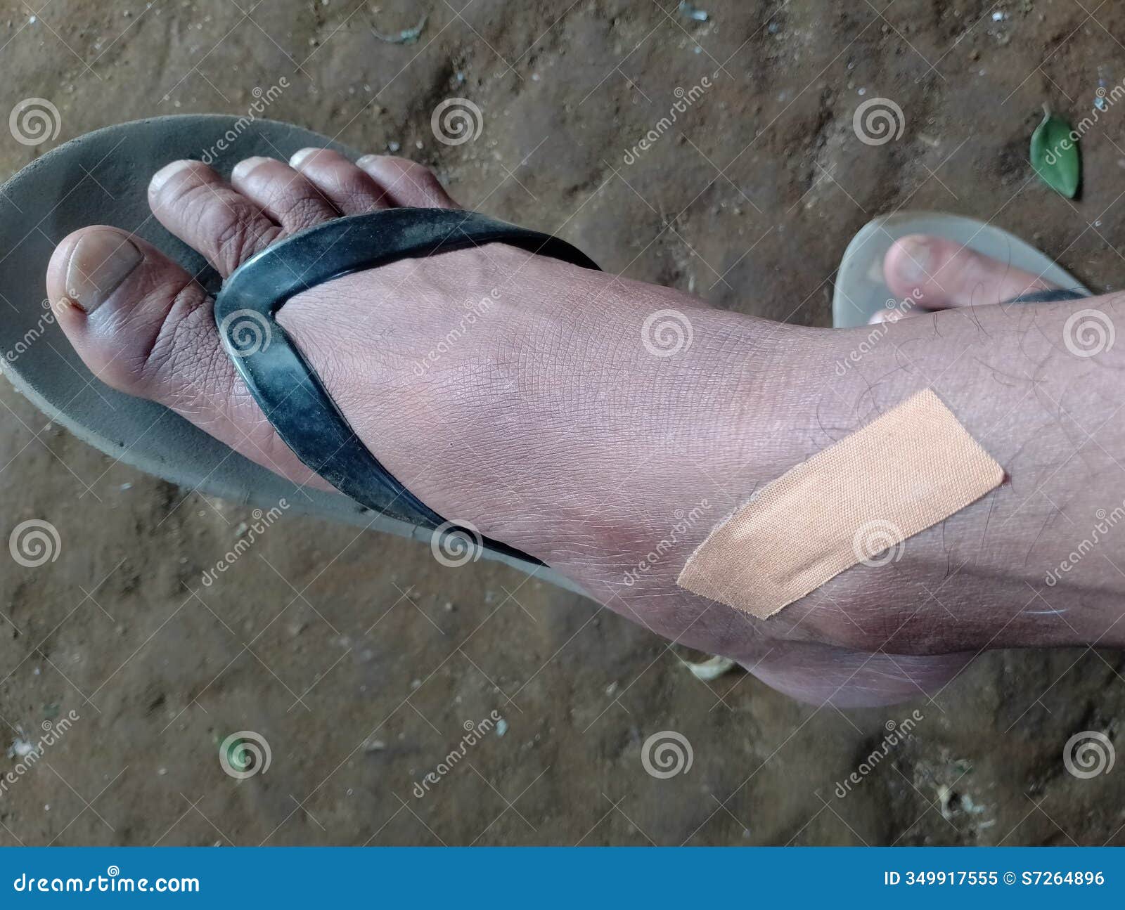 Leg Wound Healing Process, with Hansaplast Stock Image - Image of ...