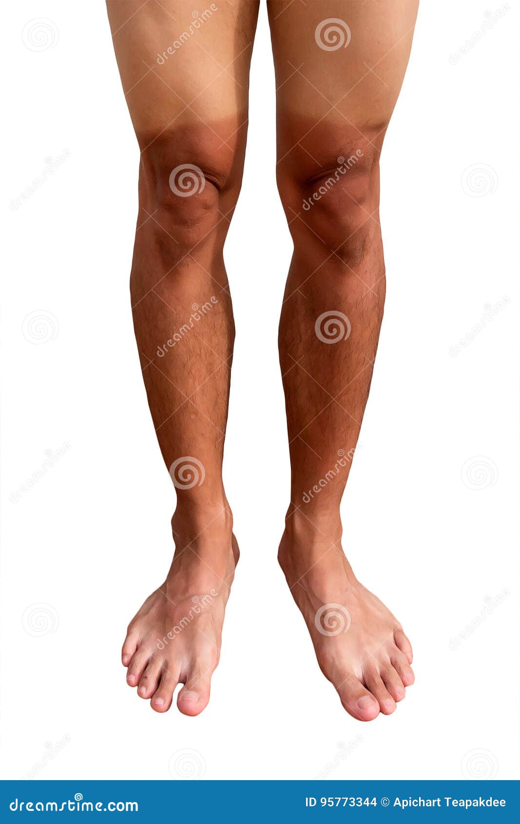 Legs of man sunburned stock photo. Image of lifestyle - 95773344