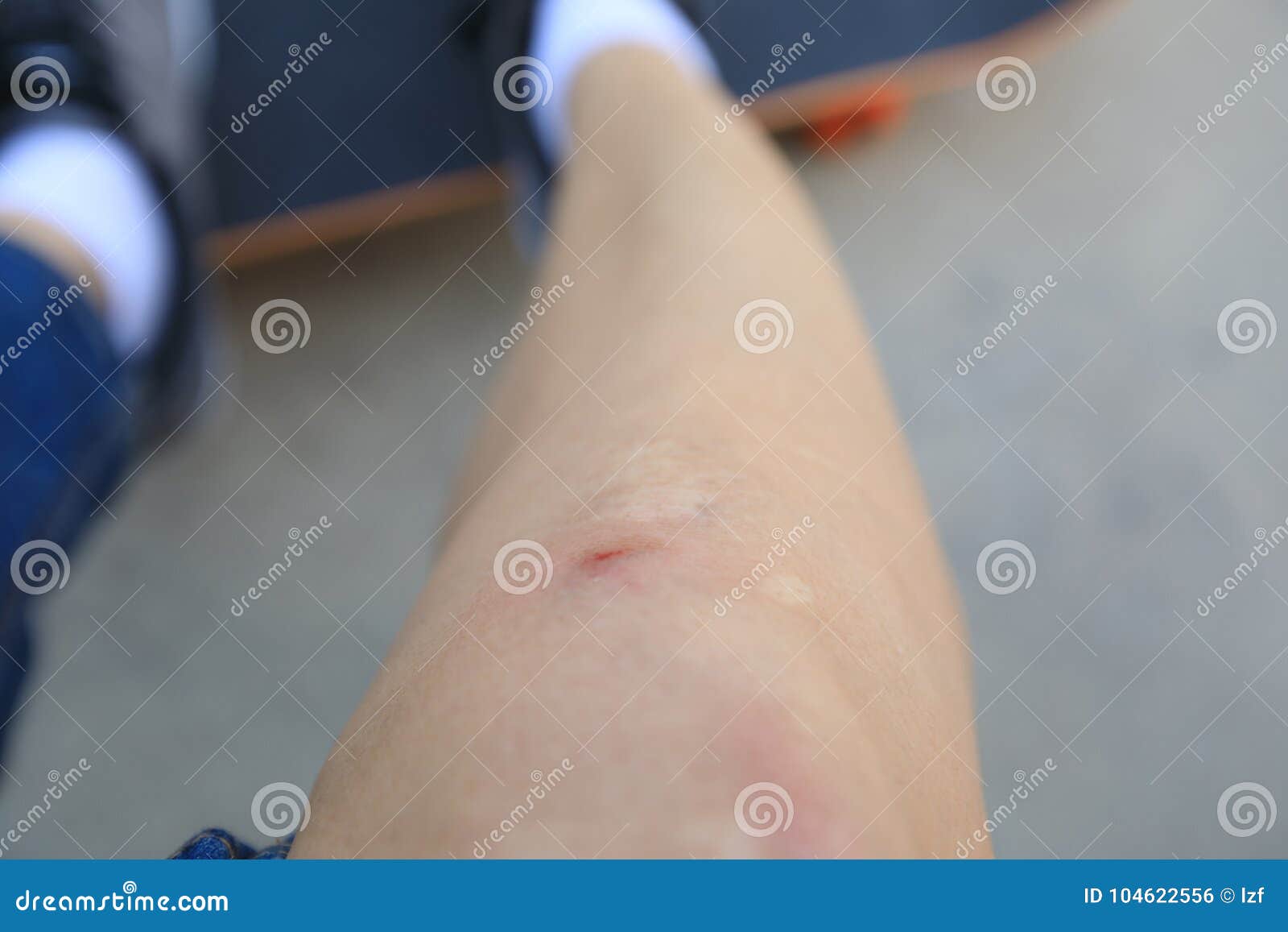 Wound On A Knee Of The Child Royalty-Free Stock Photography ...