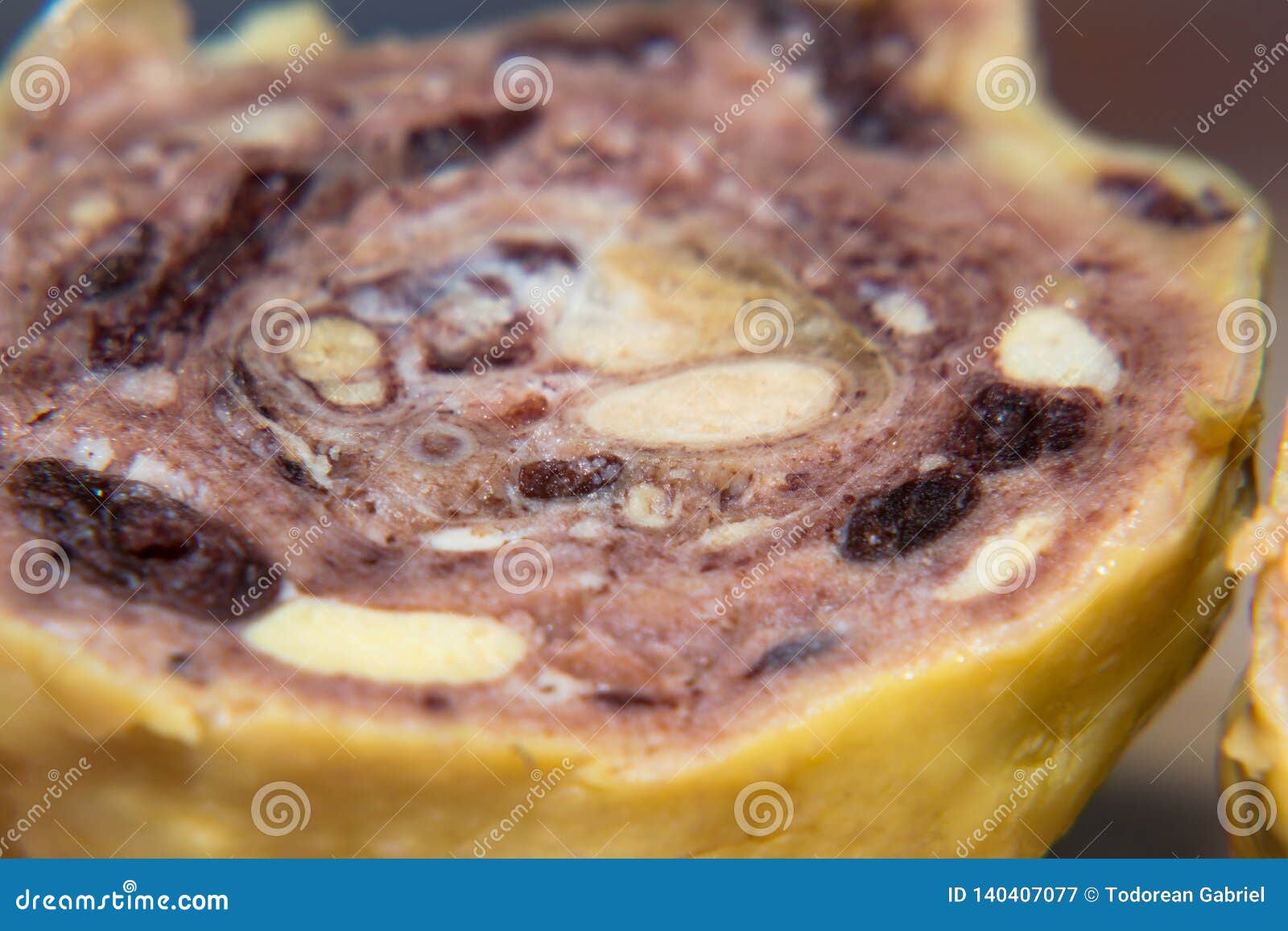 Leiomyoma of the Mesosalpinx or Lash Egg Stock Image - Image of sarcoma ...