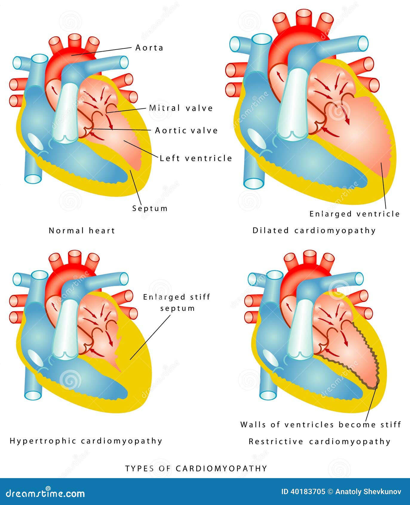 Les Maladies Du Muscle Cardiaque Illustration de Vecteur - Illustration ...