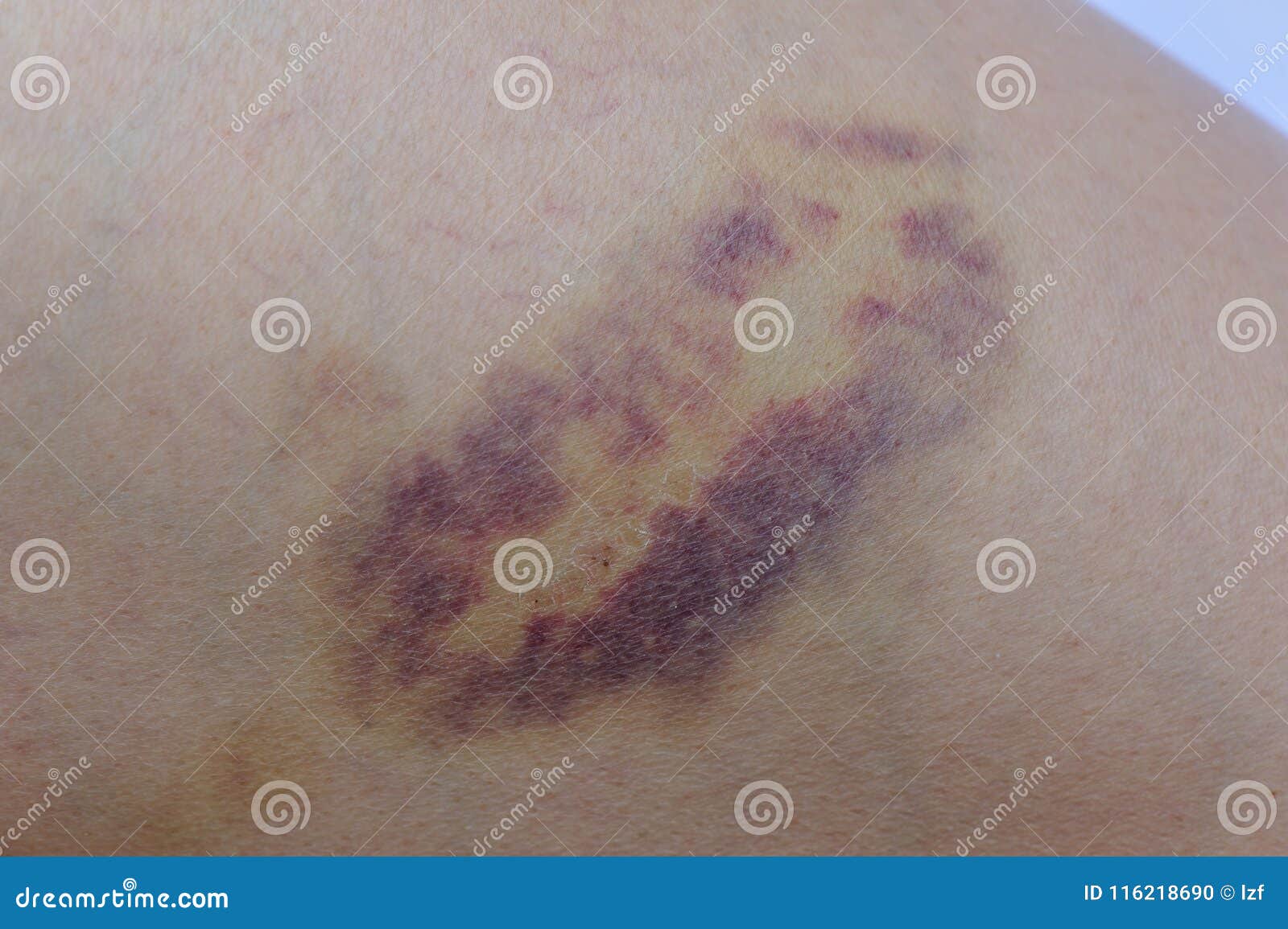 Lesión de la contusión foto de archivo. Imagen de mujer - 116218690