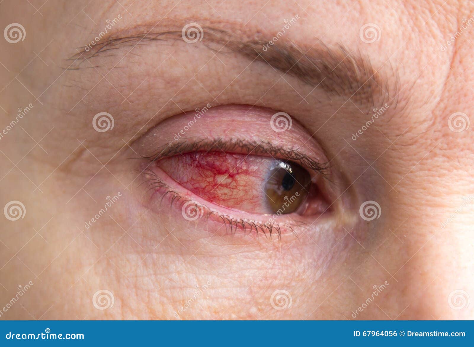 Lesión De Ojo Severa Con Sangre Foto de archivo - Imagen de glaucoma ...