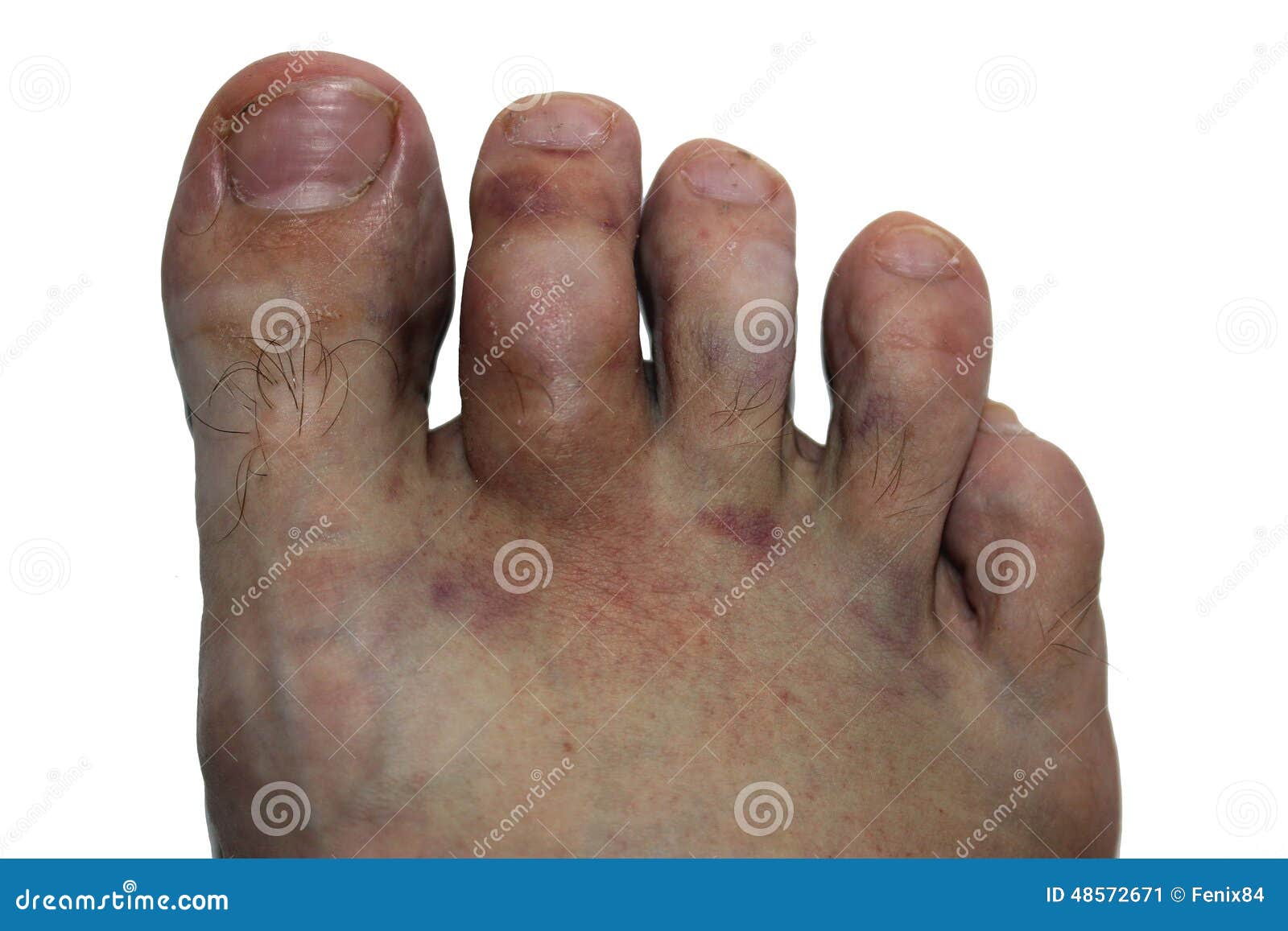 Lesión del pie imagen de archivo. Imagen de contusiones - 48572671