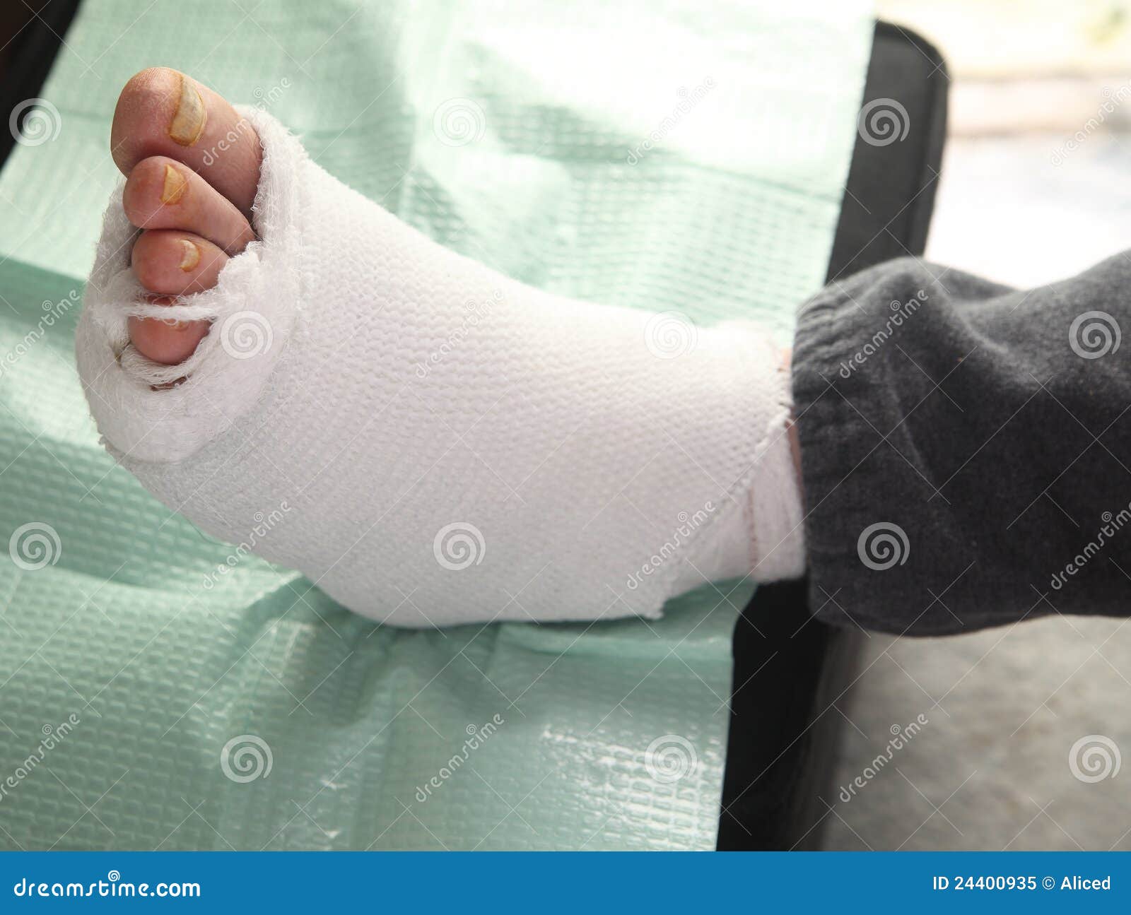 Lesión diabética del pie imagen de archivo. Imagen de médico - 24400935