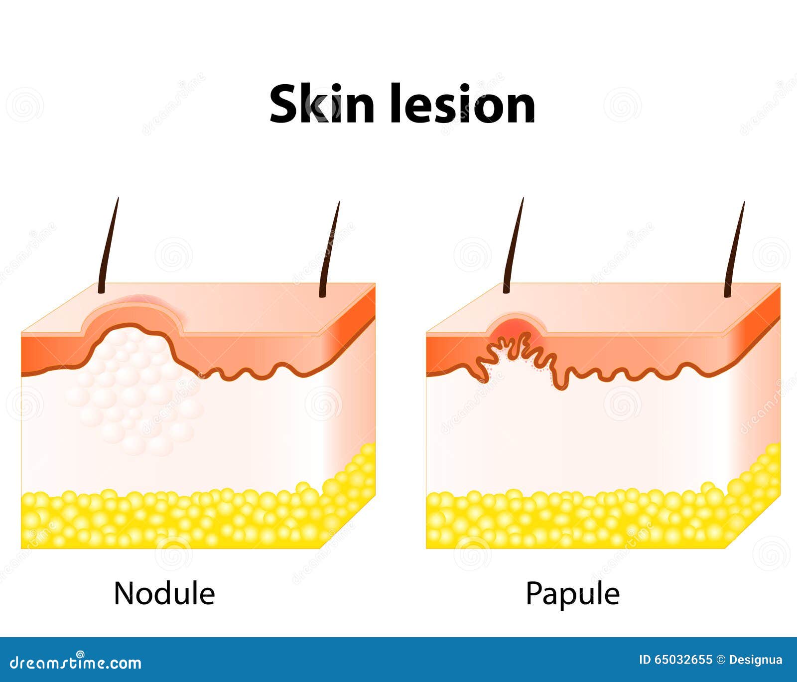 Lesione cutanea illustrazione vettoriale. Illustrazione di malattia ...
