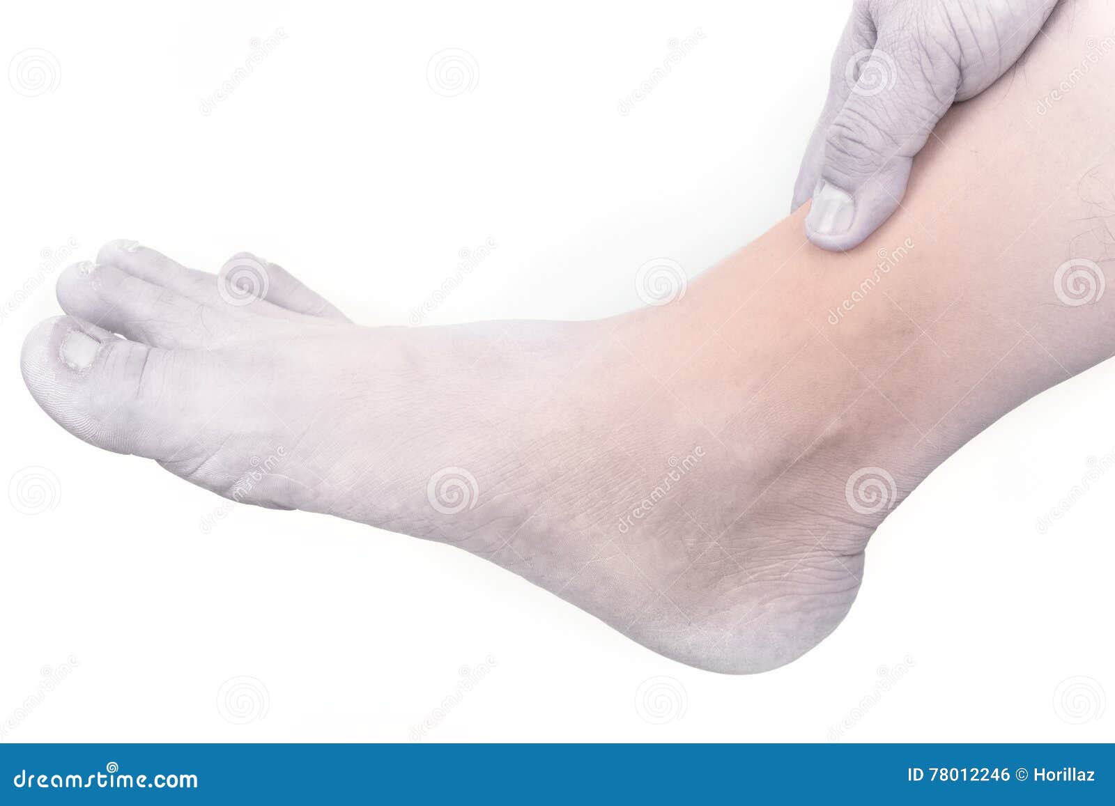 Lesione Delle Ossa Di Piede Fotografia Stock - Immagine di reumatismo ...