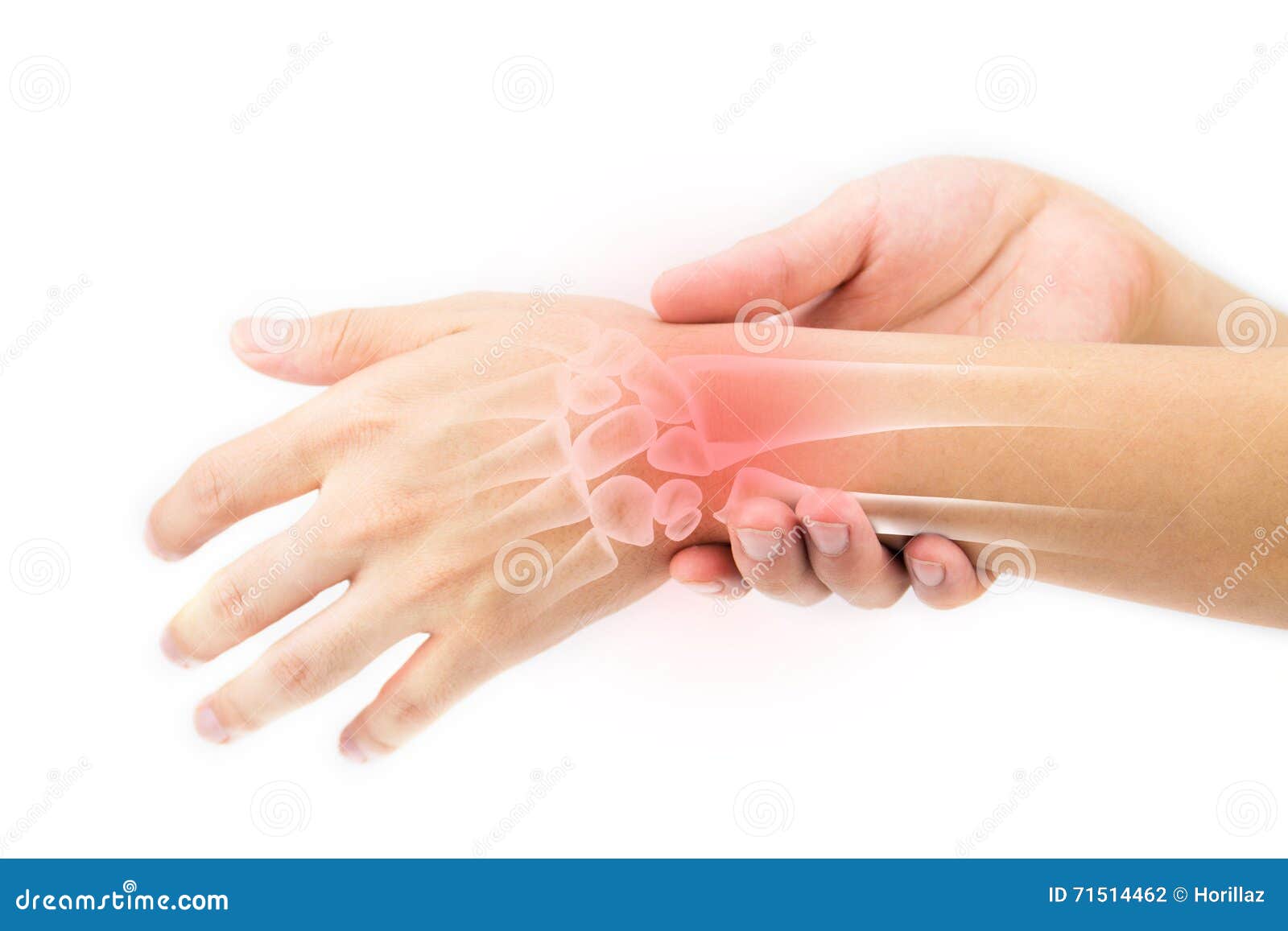 Lesione Delle Ossa Di Polso Fotografia Stock - Immagine di rotto ...