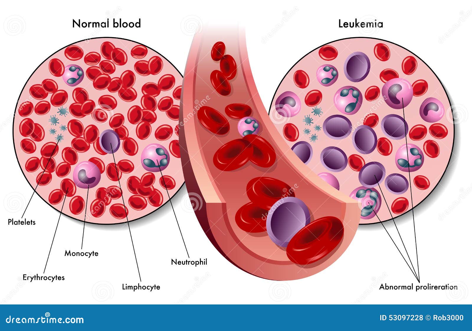 Leucemia illustrazione vettoriale. Illustrazione di spurgo - 53097228