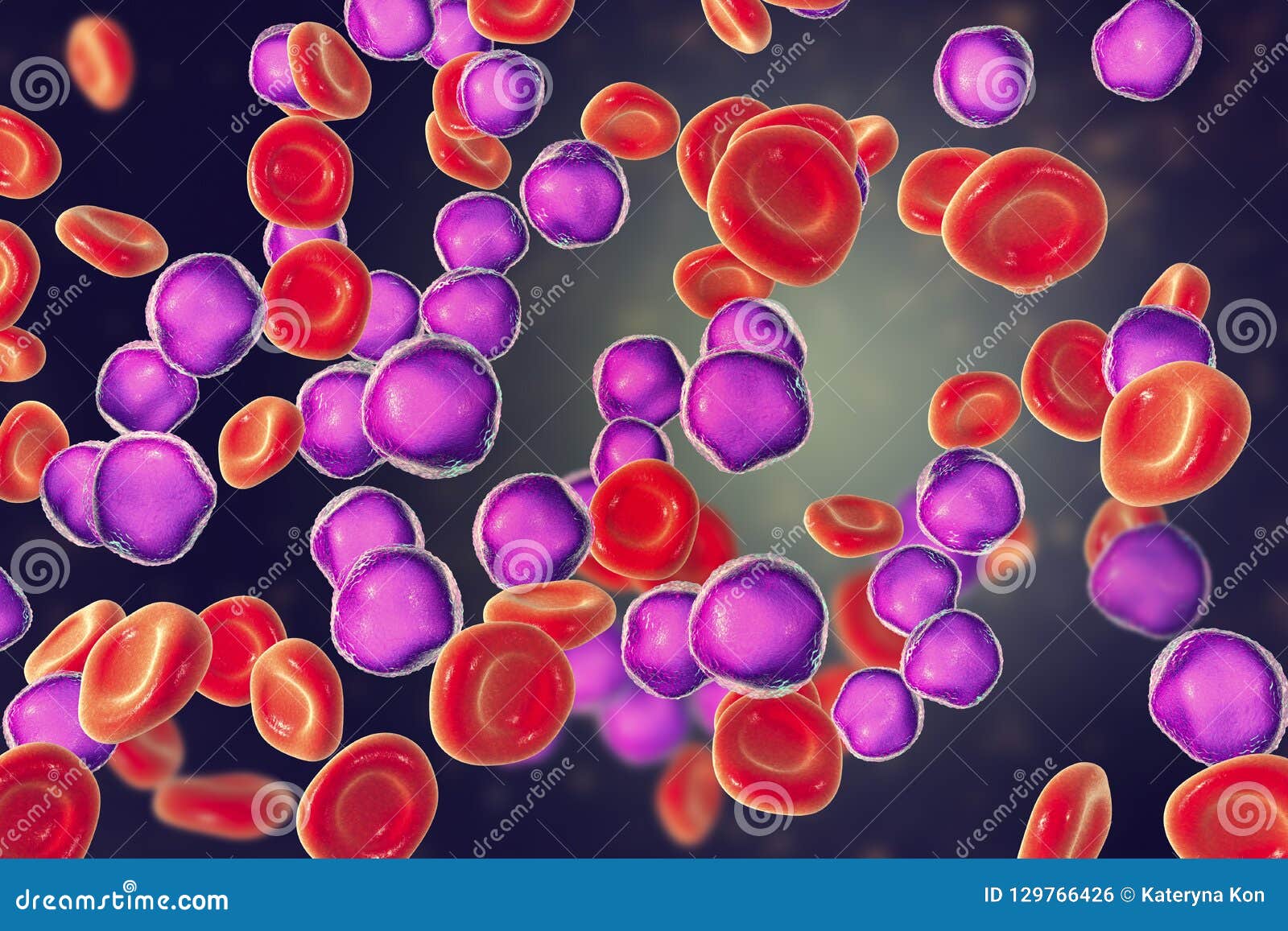 Leucemia Linfoblastica Acuta Illustrazione di Stock - Illustrazione di ...
