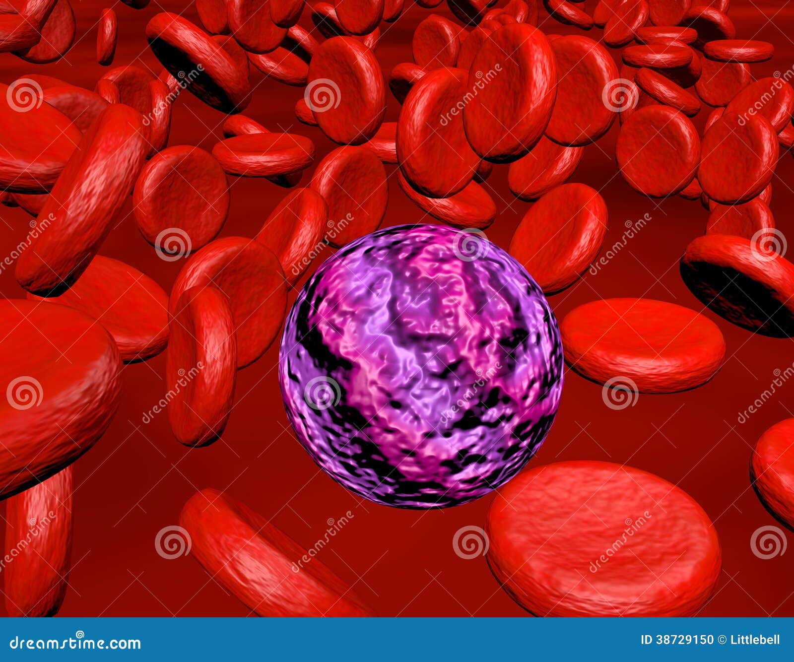 Leucemia Mieloide Aguda Foto de archivo - Imagen: 38729150