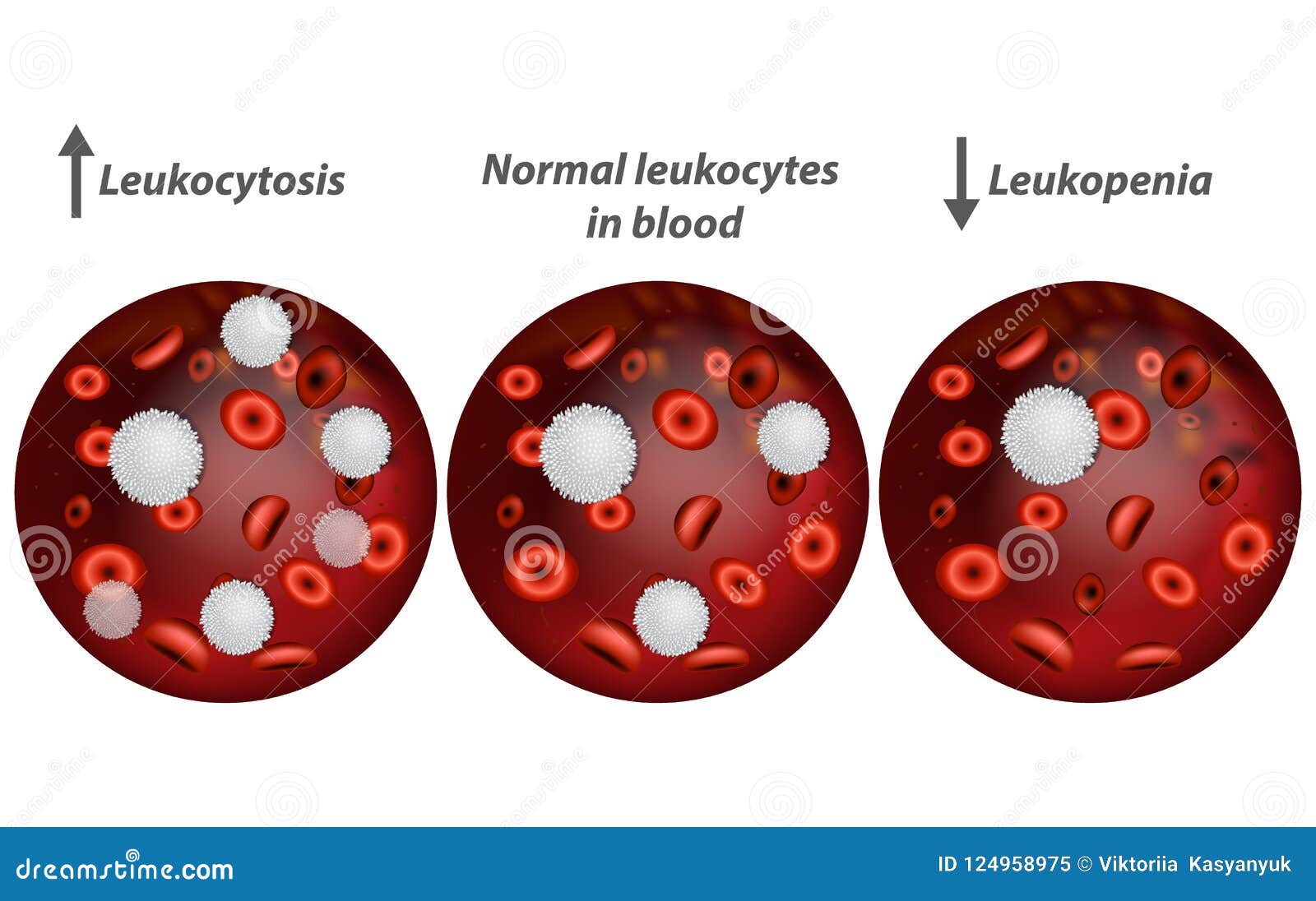 Leucocitose e leucopenia ilustração do vetor. Ilustração de anatomia ...
