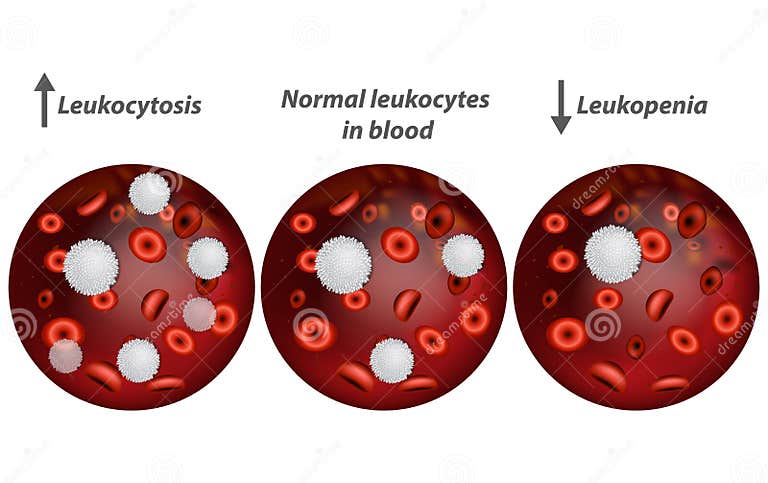 Leucocitose e leucopenia ilustração do vetor. Ilustração de anatomia ...