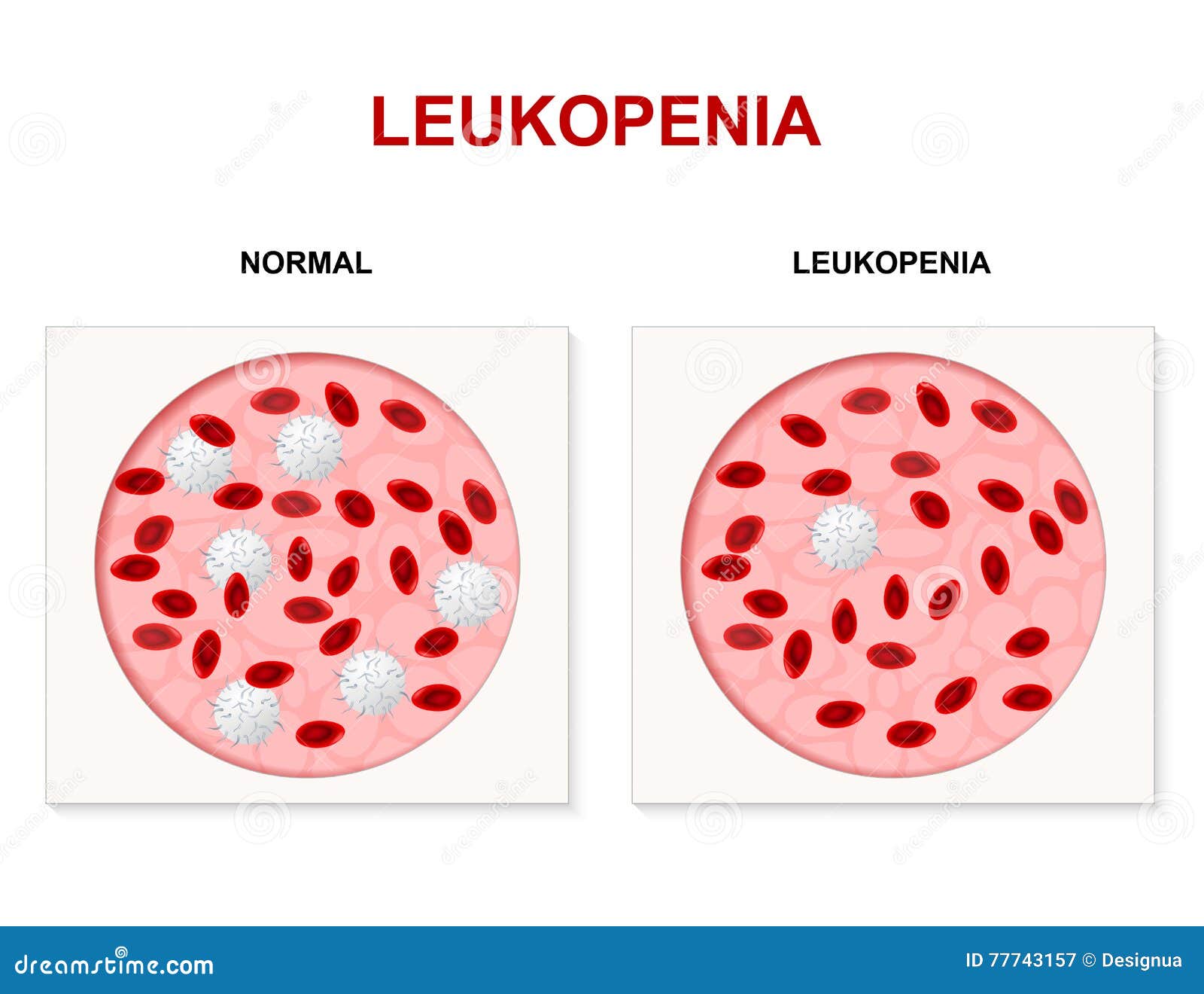 Leucopenia, Leukocytopenia O Leucopenia Illustrazione Vettoriale ...