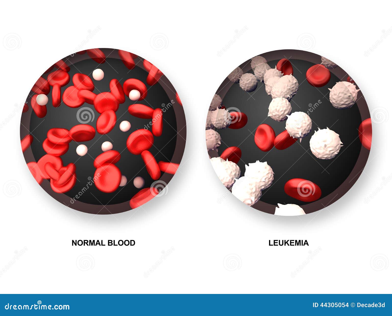 Leukemi vs normalt blod stock illustrationer. Illustration av terminal ...