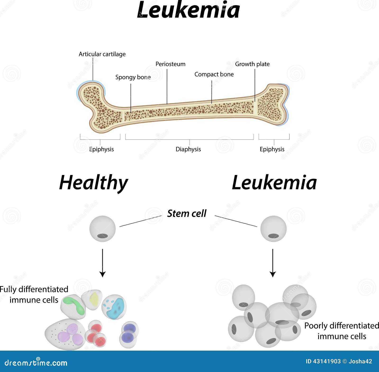 Leukemia Cartoons, Illustrations & Vector Stock Images - 429 Pictures ...