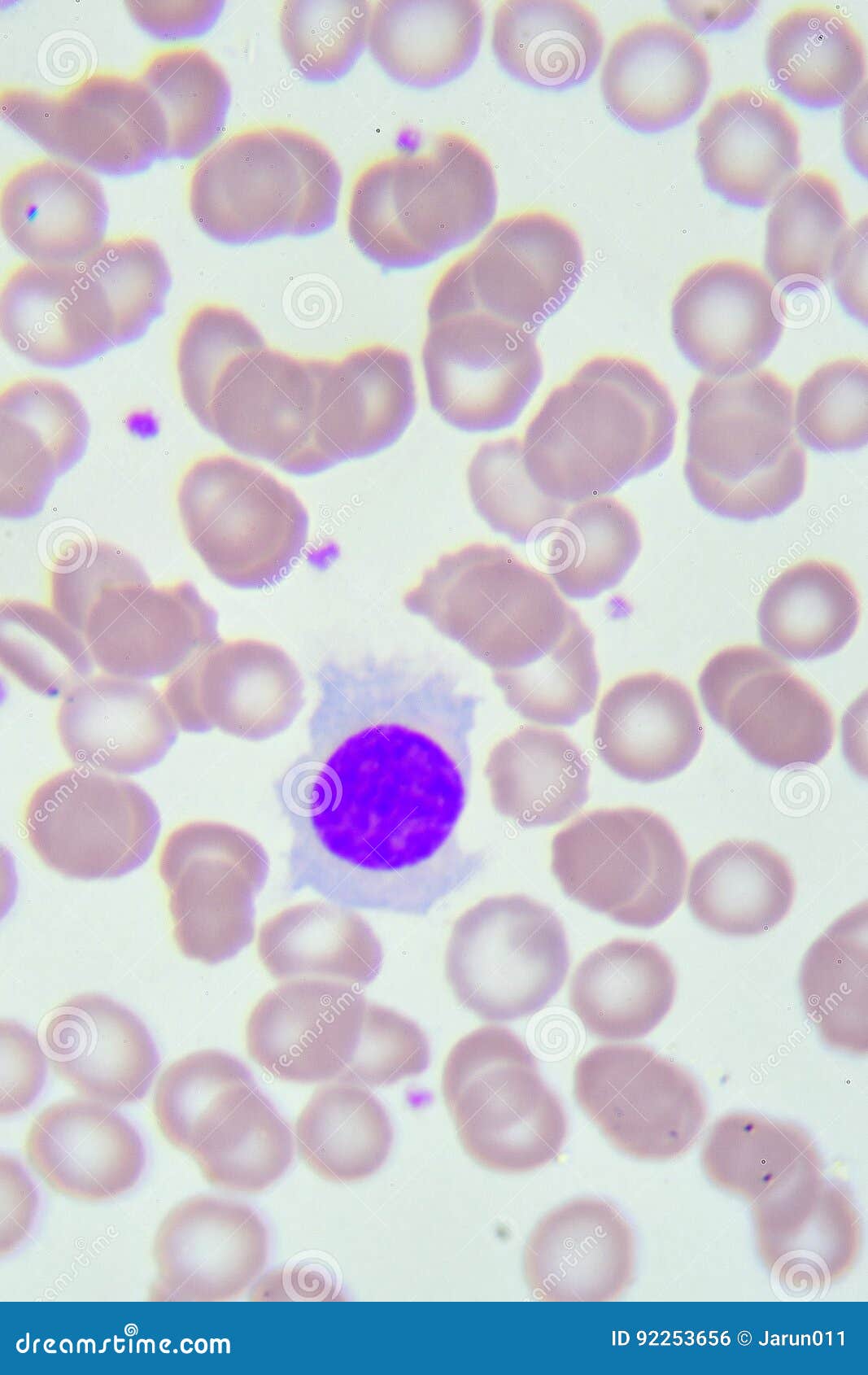 Leukemia cell stock photo. Image of pathology, cancer - 92253656