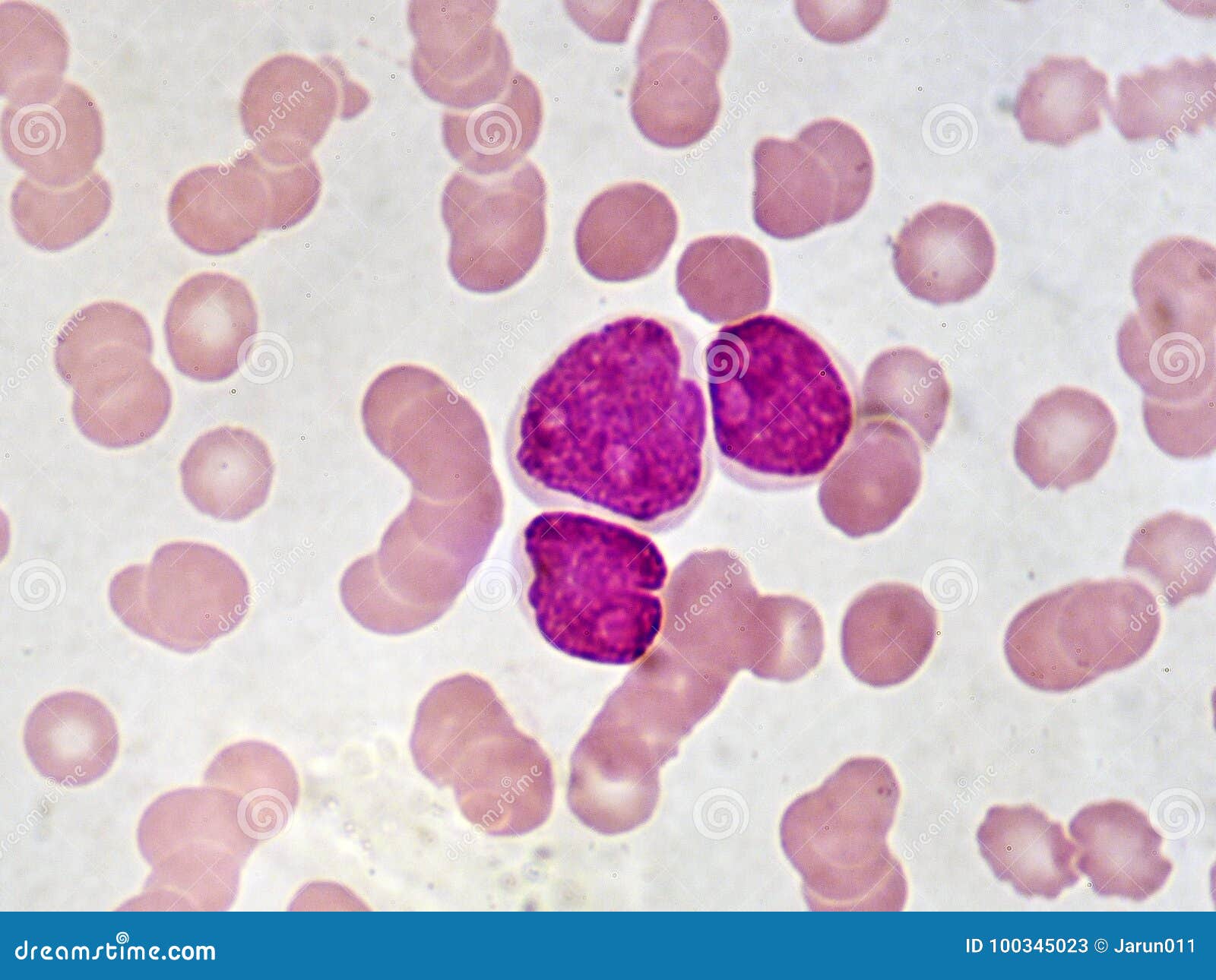 Leukemia cells stock image. Image of disease, anemia - 100345023