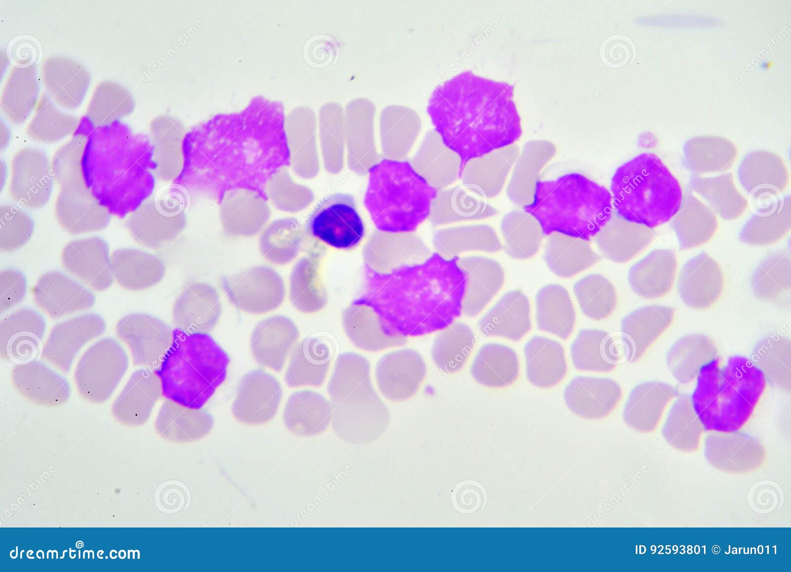 Leukemia cells stock image. Image of erythrocyte, lymphocyte - 92593801
