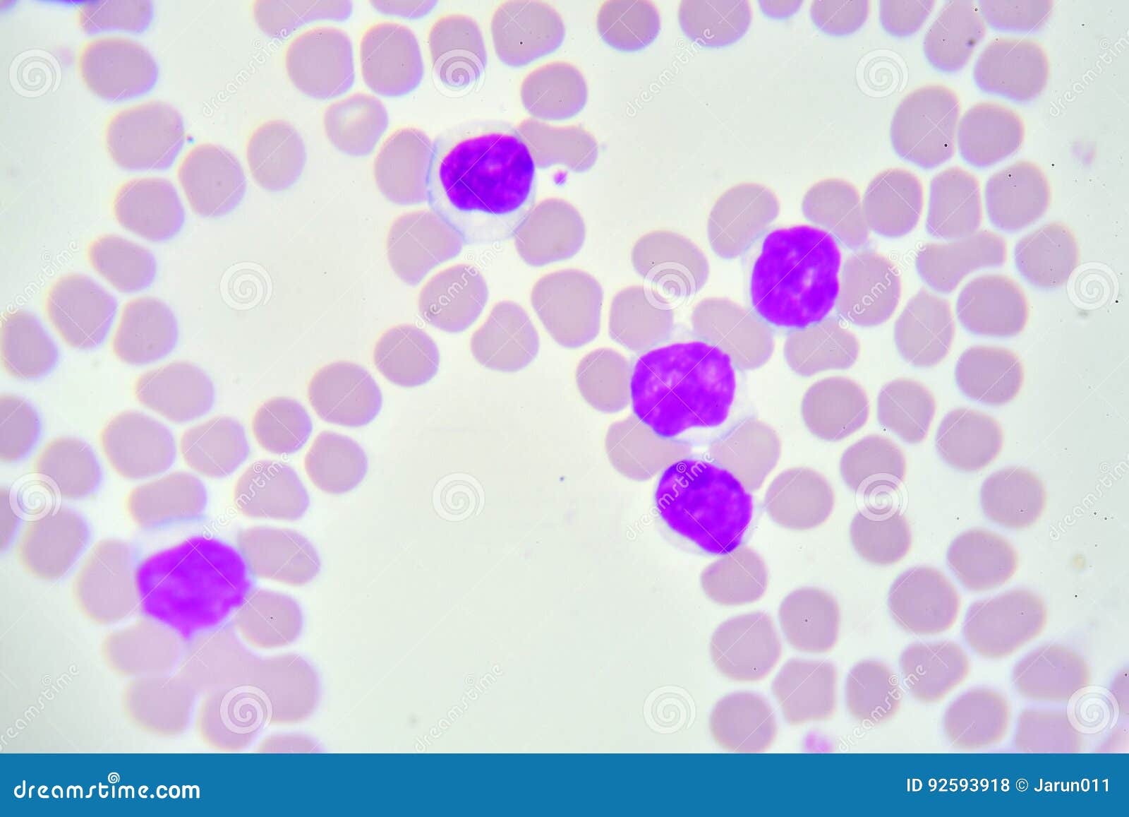 Leukemia cells stock photo. Image of analyzing, pathology - 92593918